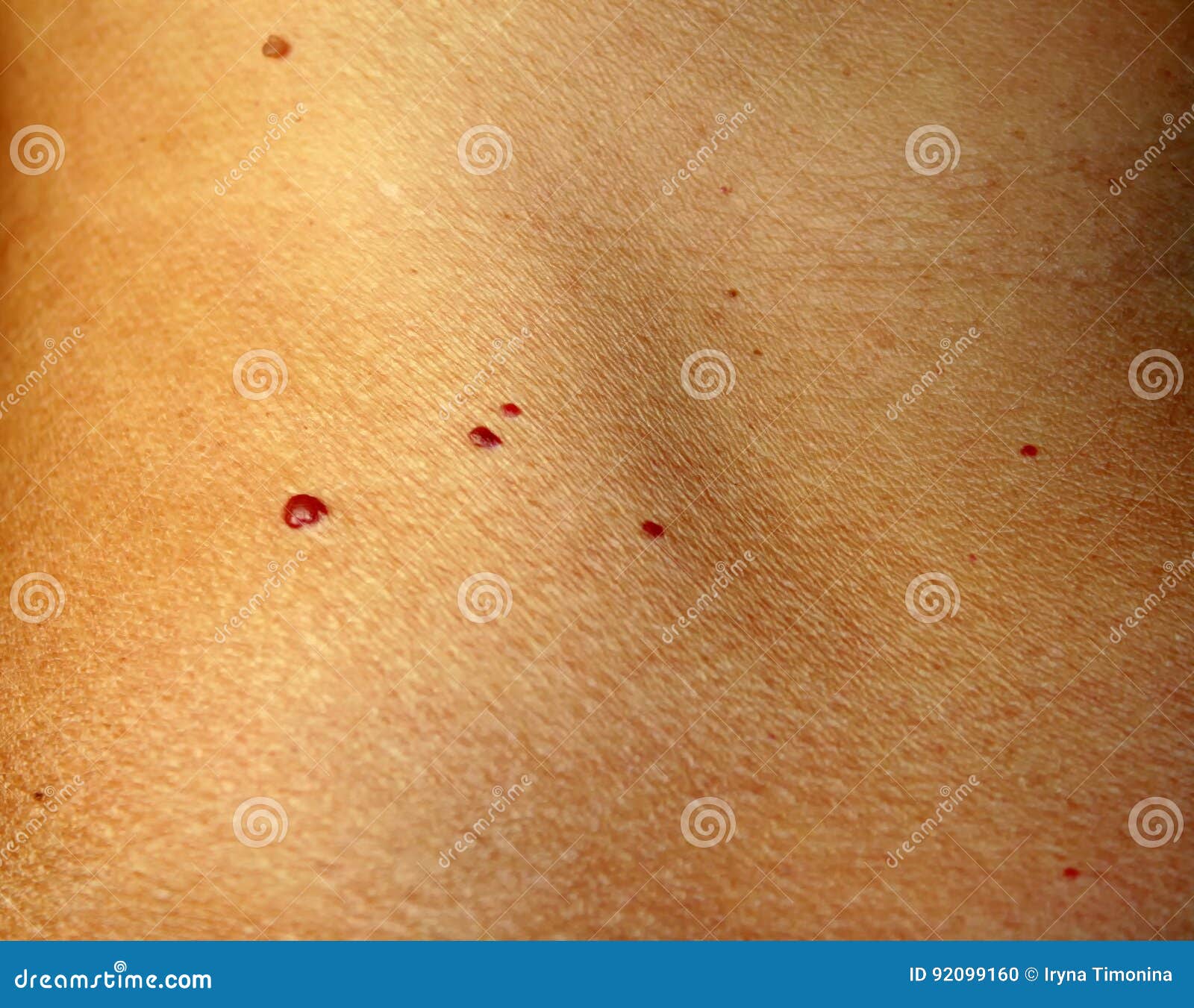 Angioma On The Skin. Red Moles On The Body. Many Birthmarks. Royalty ... Angioma On The Skin. Red Moles On The Body. Many Birthmarks. Royalty ...