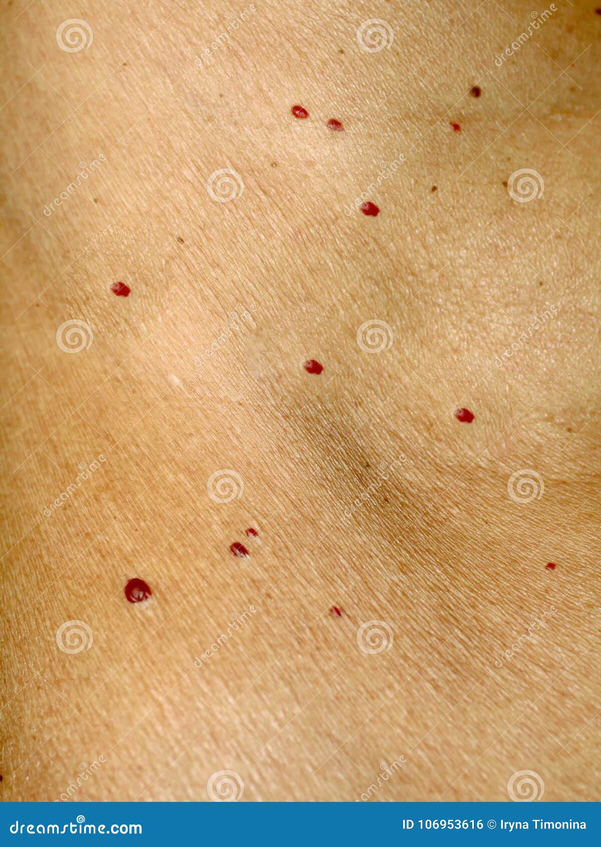 Angioma on the Skin. Red Moles on the Body. Many Birthmarks. Stock ... Angioma on the Skin. Red Moles on the Body. Many Birthmarks. Stock ...