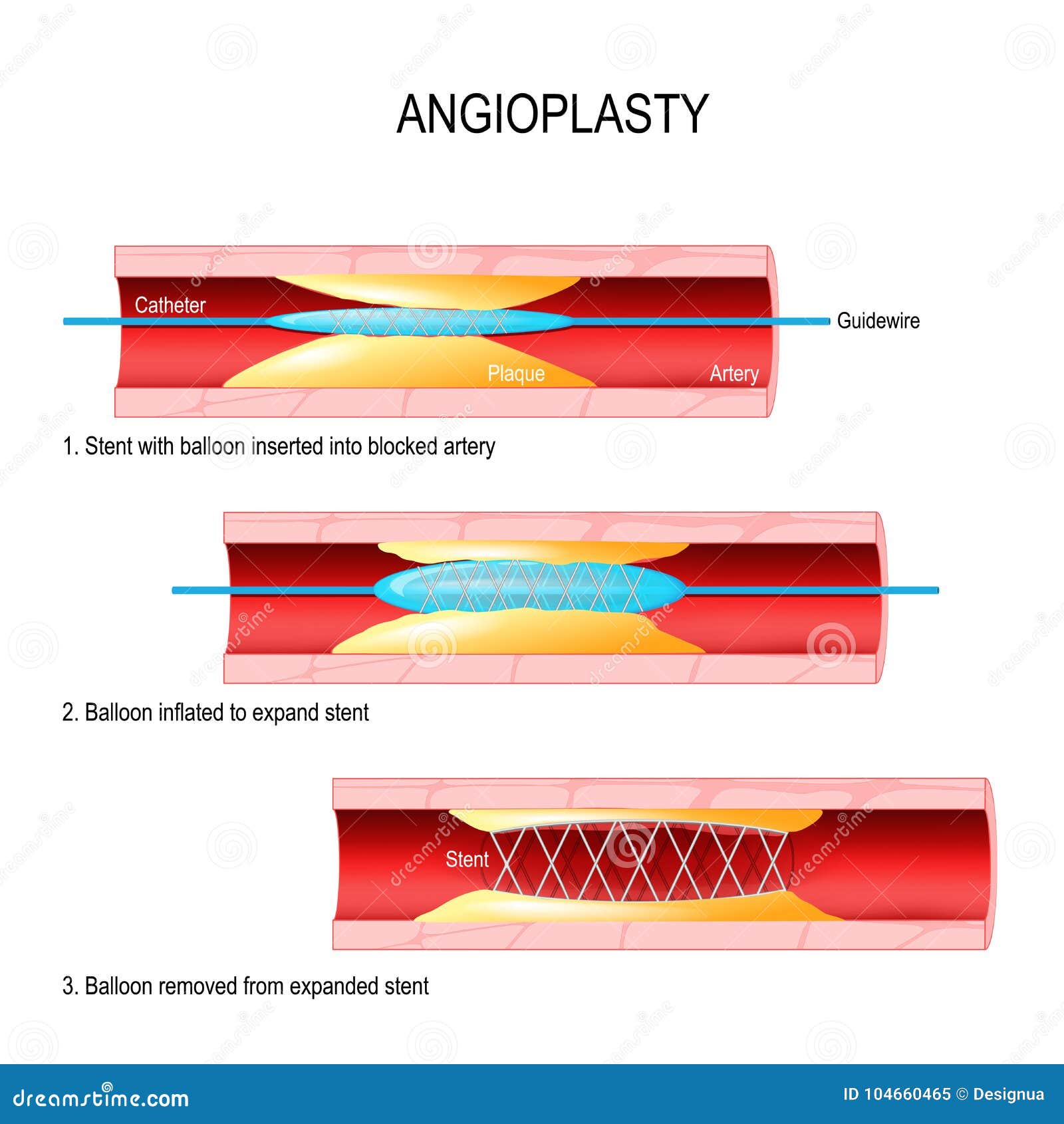Angioplastie Implantation De Stent Illustration de Vecteur ...