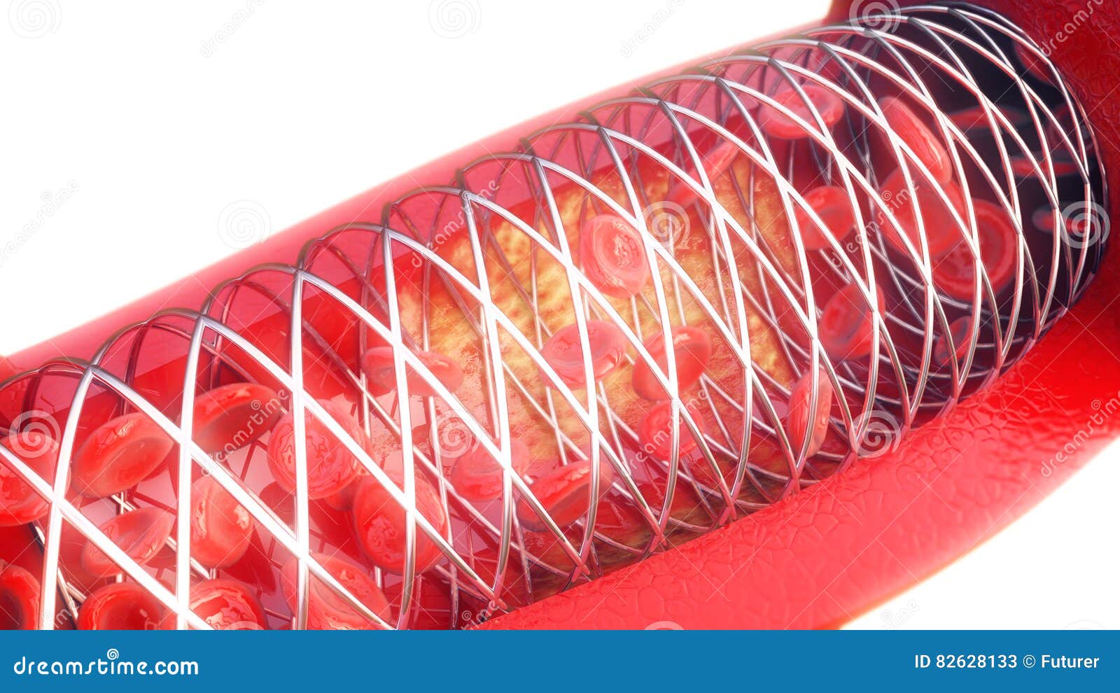 Angioplasty. Stent Delivery And Implantation. Deflated Balloon Catheter ...