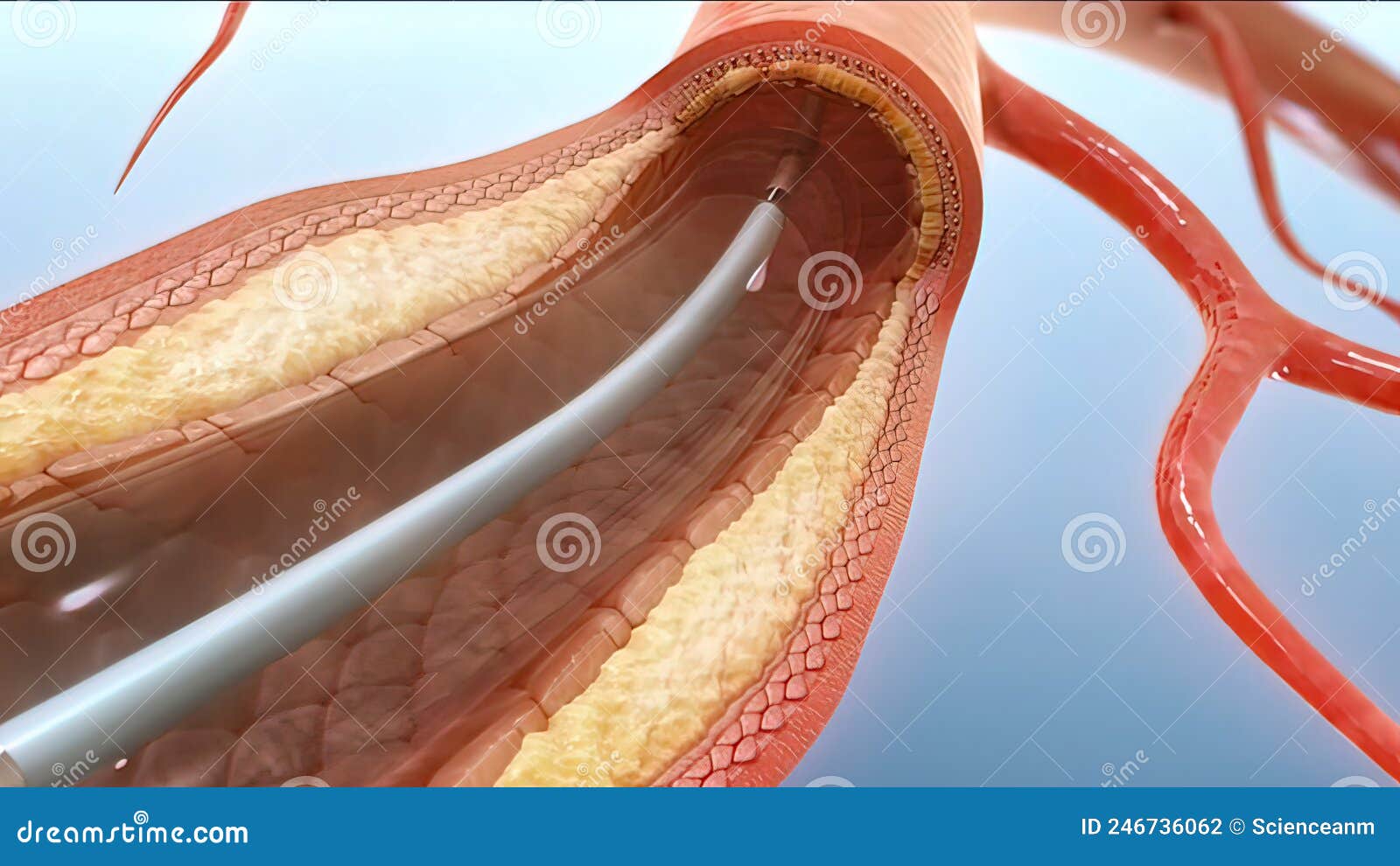 Angioplasty and Vascular Stenting Stock Illustration - Illustration of ...