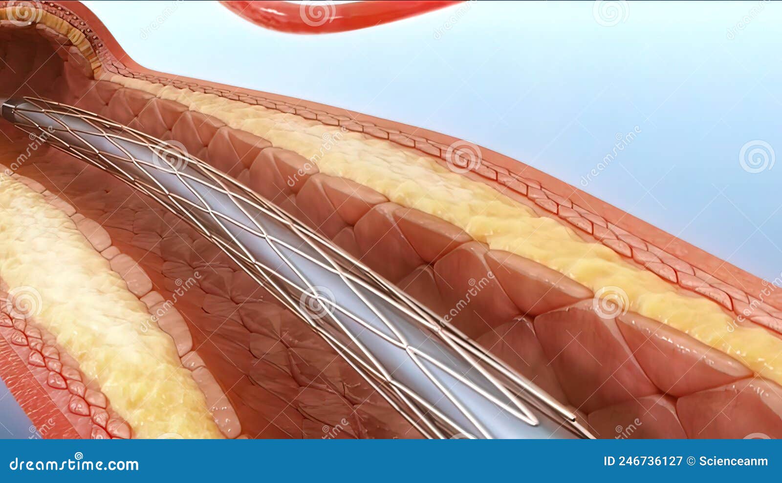 Angioplasty and Vascular Stenting Stock Illustration - Illustration of ...