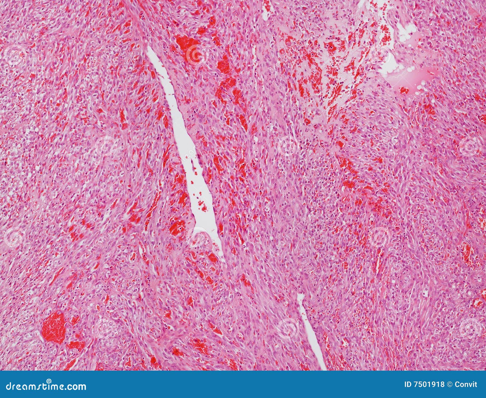 Angiosarcoma micrograph stock photo. Image of vessel, capillary - 7501918