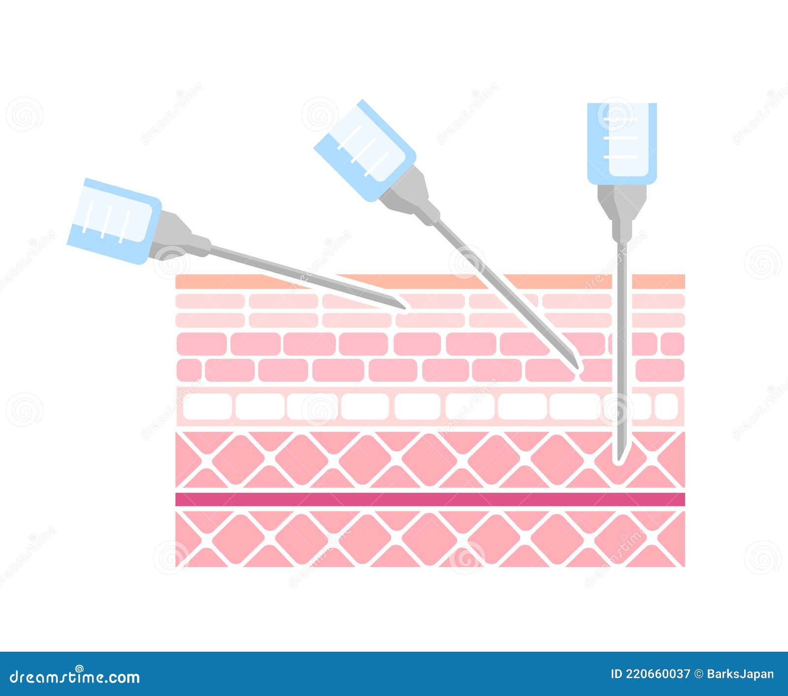 Angles for Inserting Injections Vector Illustration Stock Vector ...