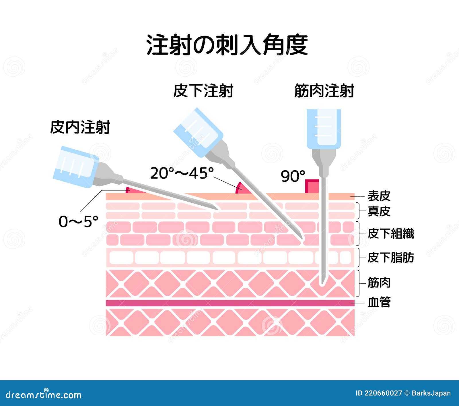 Angles for Inserting Injections Vector Illustration Stock Vector ...