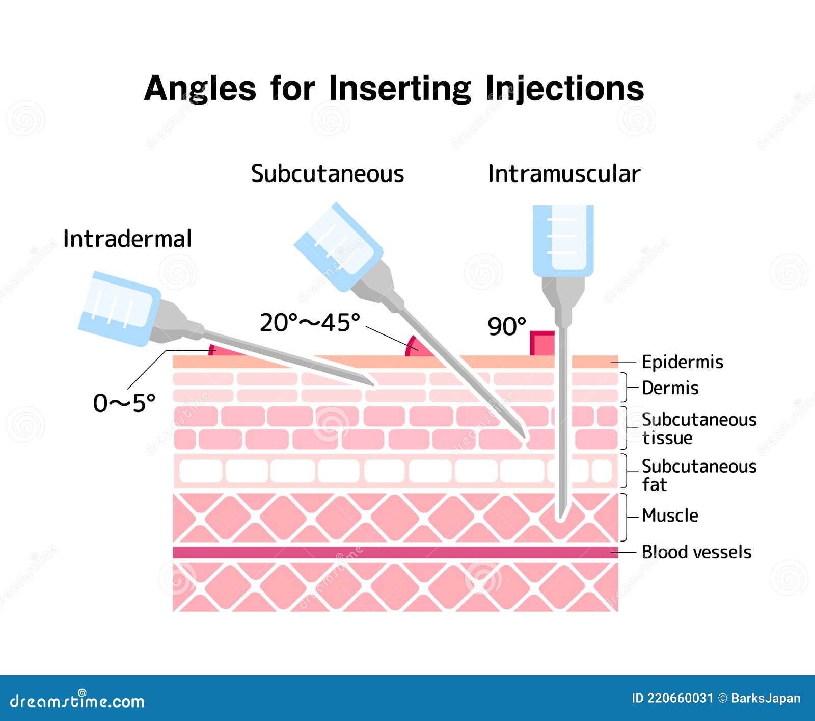 Angles for Inserting Injections Vector Illustration Stock Vector ... Angles for Inserting Injections Vector Illustration Stock Vector ...