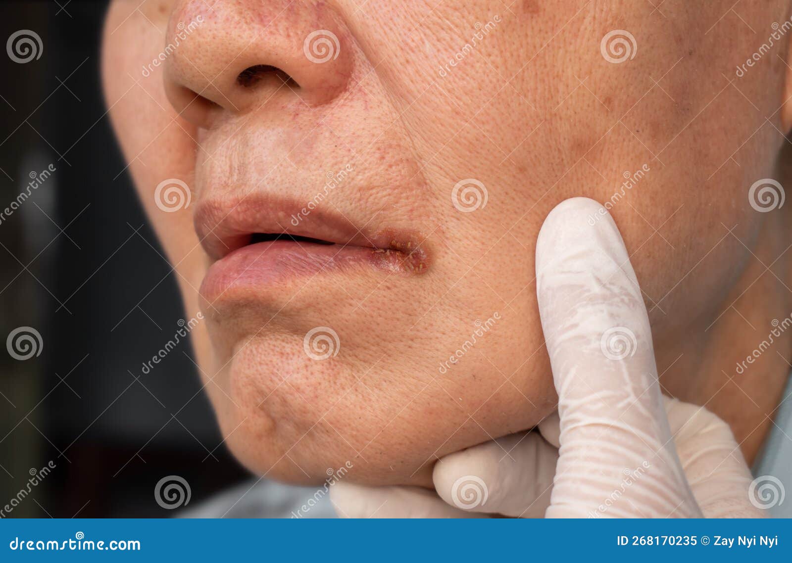 Angular Stomatitis or Angular Cheilitis or Perleche in Asian Man. Mouth ...