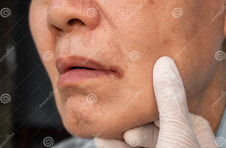 Angular Stomatitis or Angular Cheilitis or Perleche in Asian Man. Mouth ...
