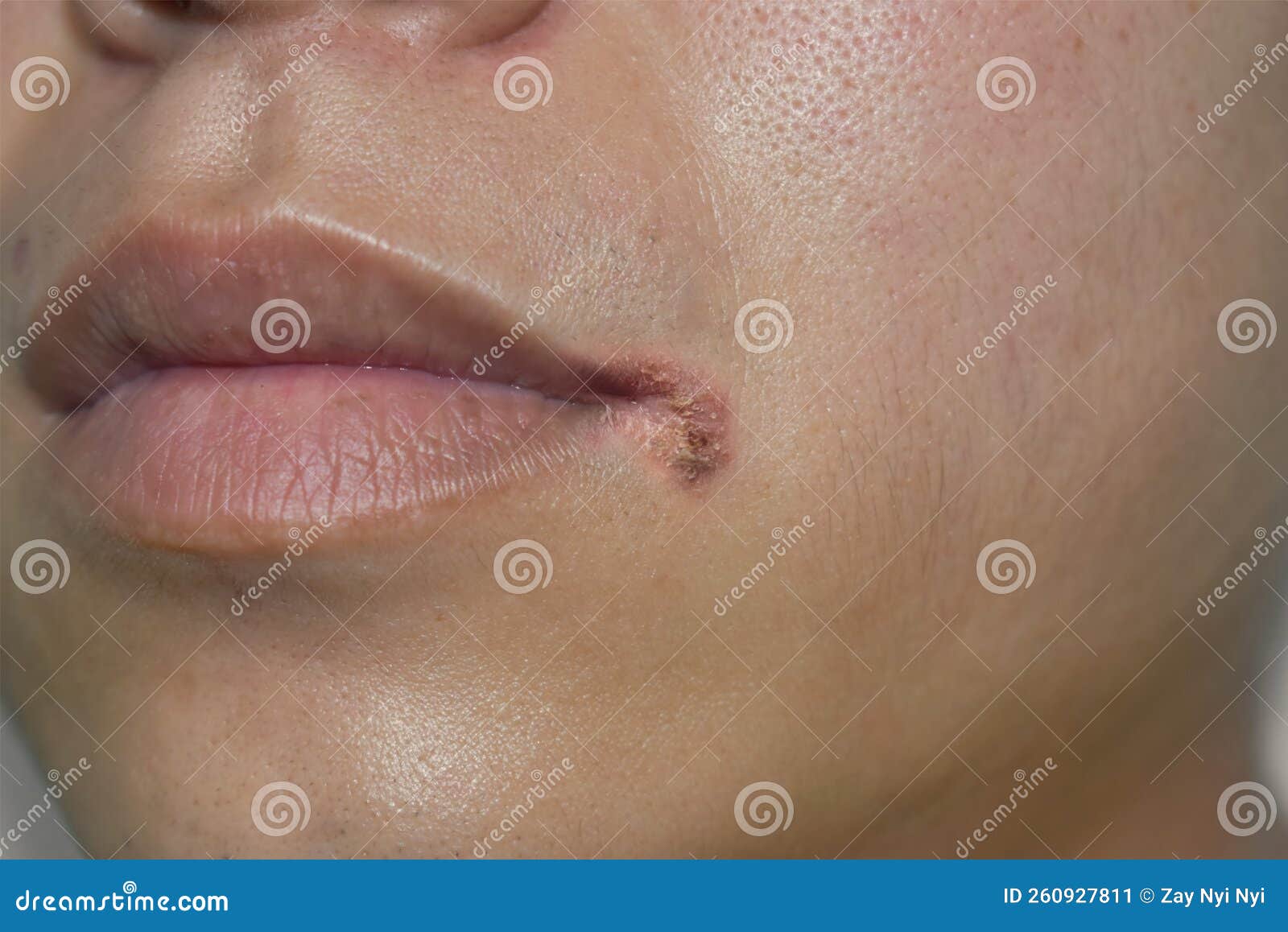 Angular Stomatitis or Angular Cheilitis or Perleche in Asian Man ...