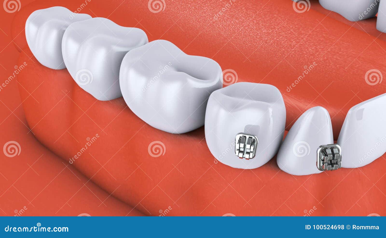Animation dental brackets stock footage. Video of brackets - 100524698