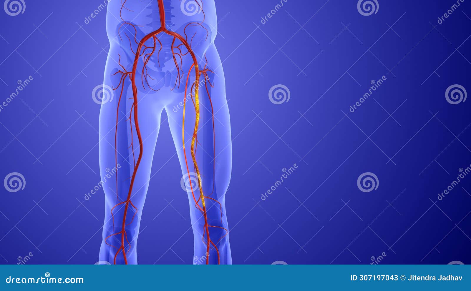Animation Of Peripheral Artery Bypass Surgery Stock Image Image Of Clot Vessels 307197043