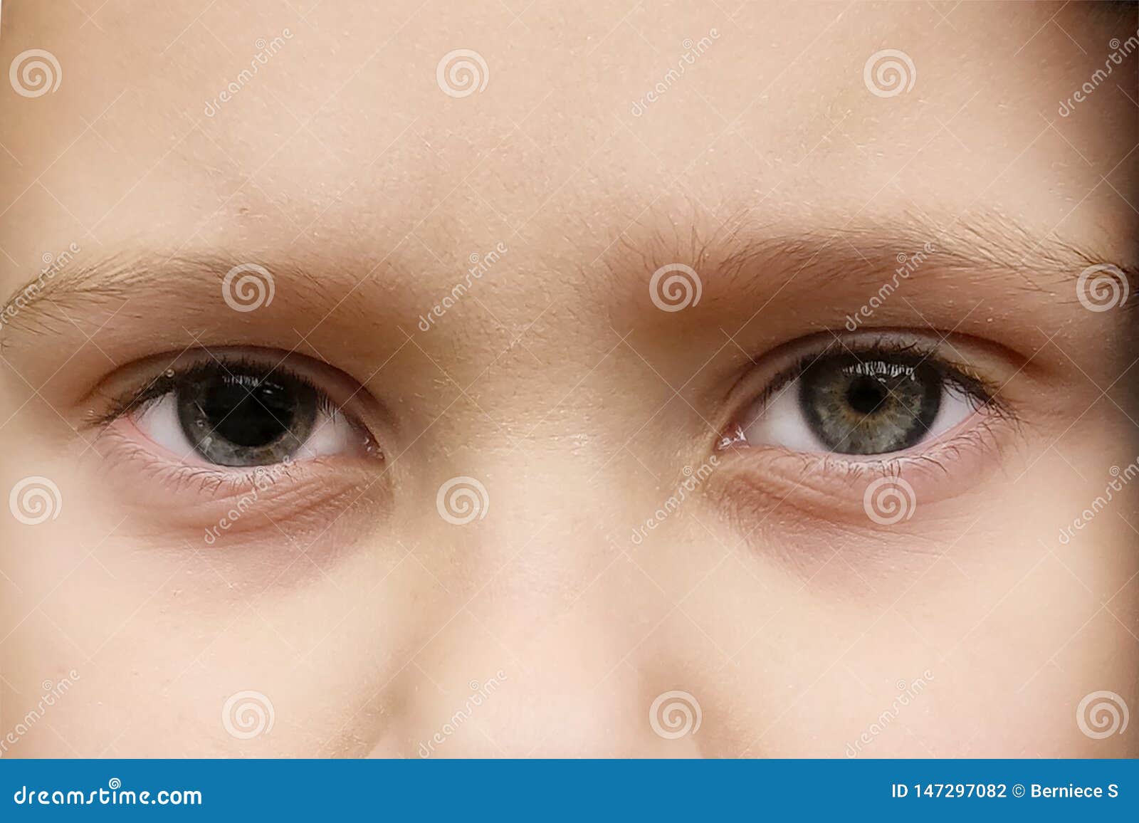 Anisocoria Stock Photos - Free & Royalty-Free Stock Photos from Dreamstime