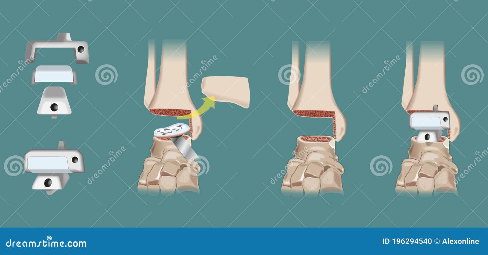 Arthroplasty Cartoons, Illustrations & Vector Stock Images - 428 ...