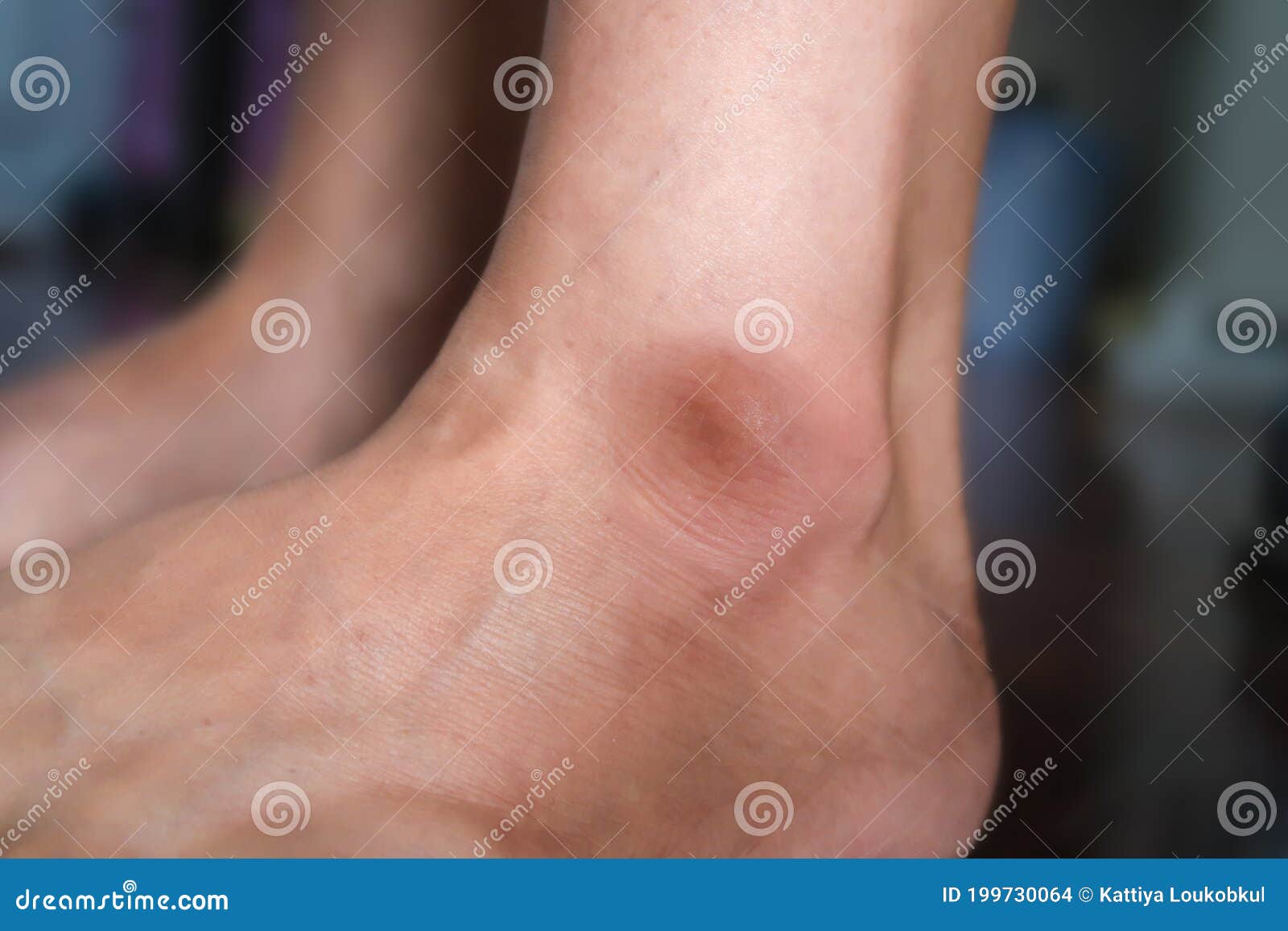 Ankle Cyst Has a Swollen Lump Stock Photo - Image of illness, foot ...