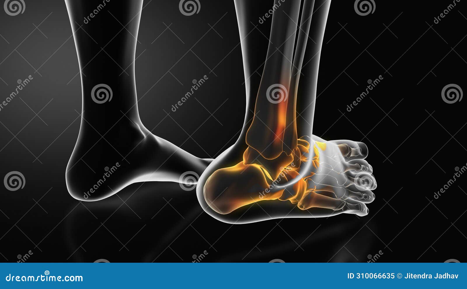 Ankle Injury with Dislocation and Sprains Stock Image - Image of ...