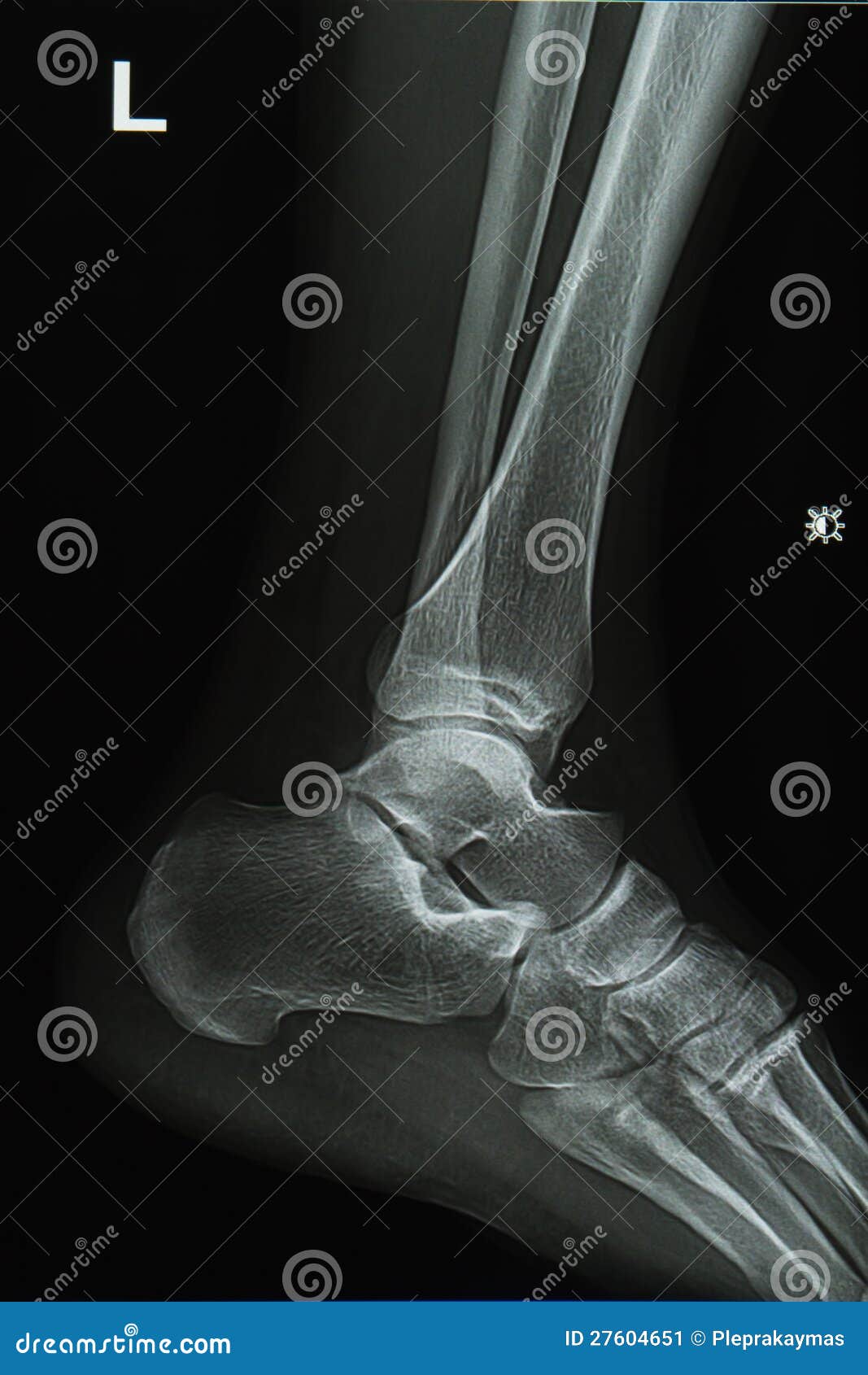 Ankle and Foot X-rays Image Stock Image - Image of scan, bone: 27604651