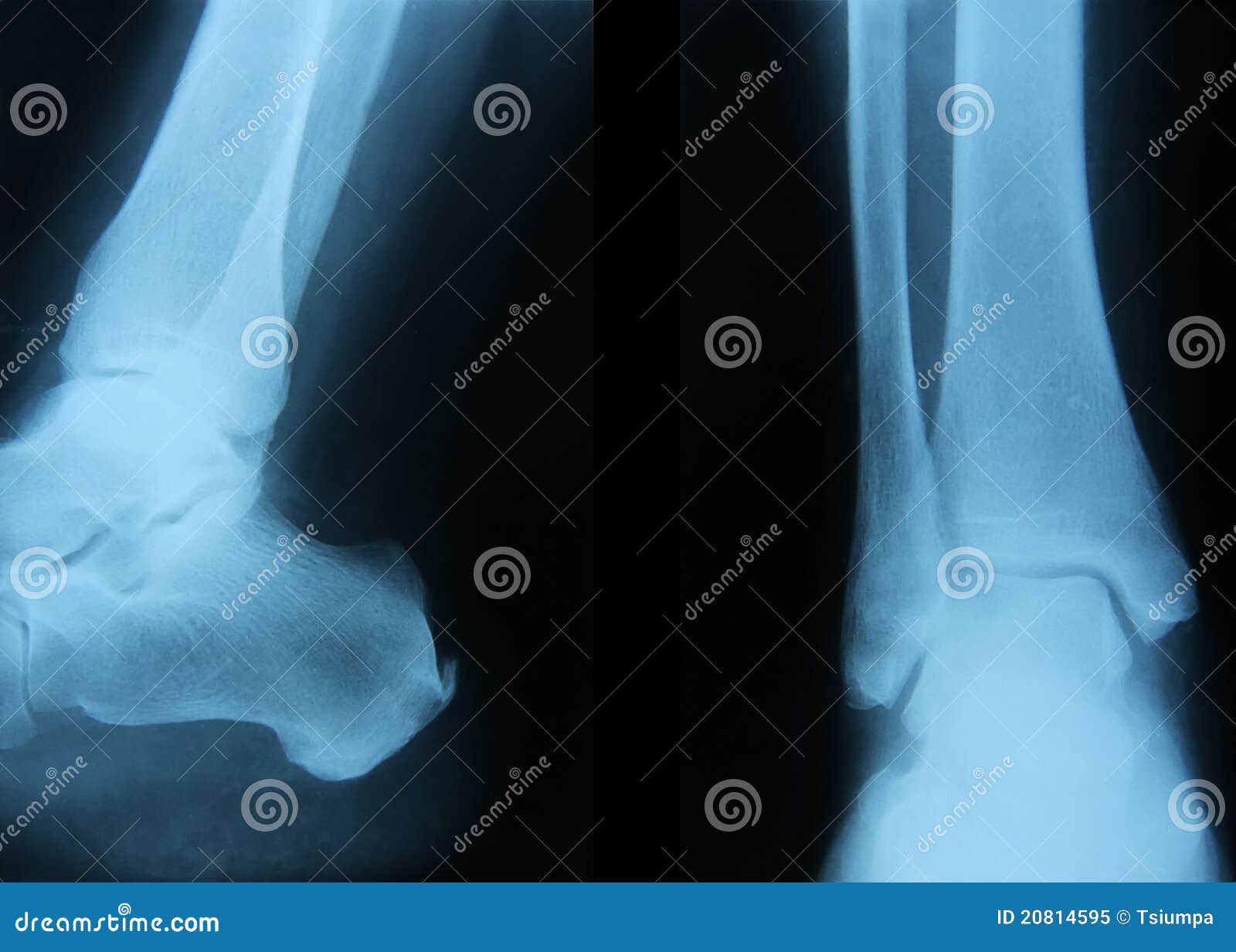 Ankle joint stock image. Image of rheumatism, joint, anatomic - 20814595