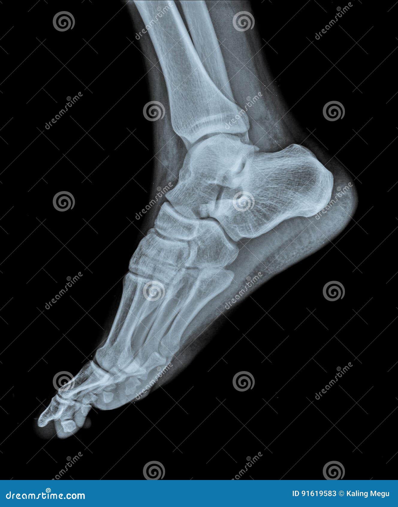 Ankle Joint with Foot and Tibia Stock Image - Image of bone, femur ...