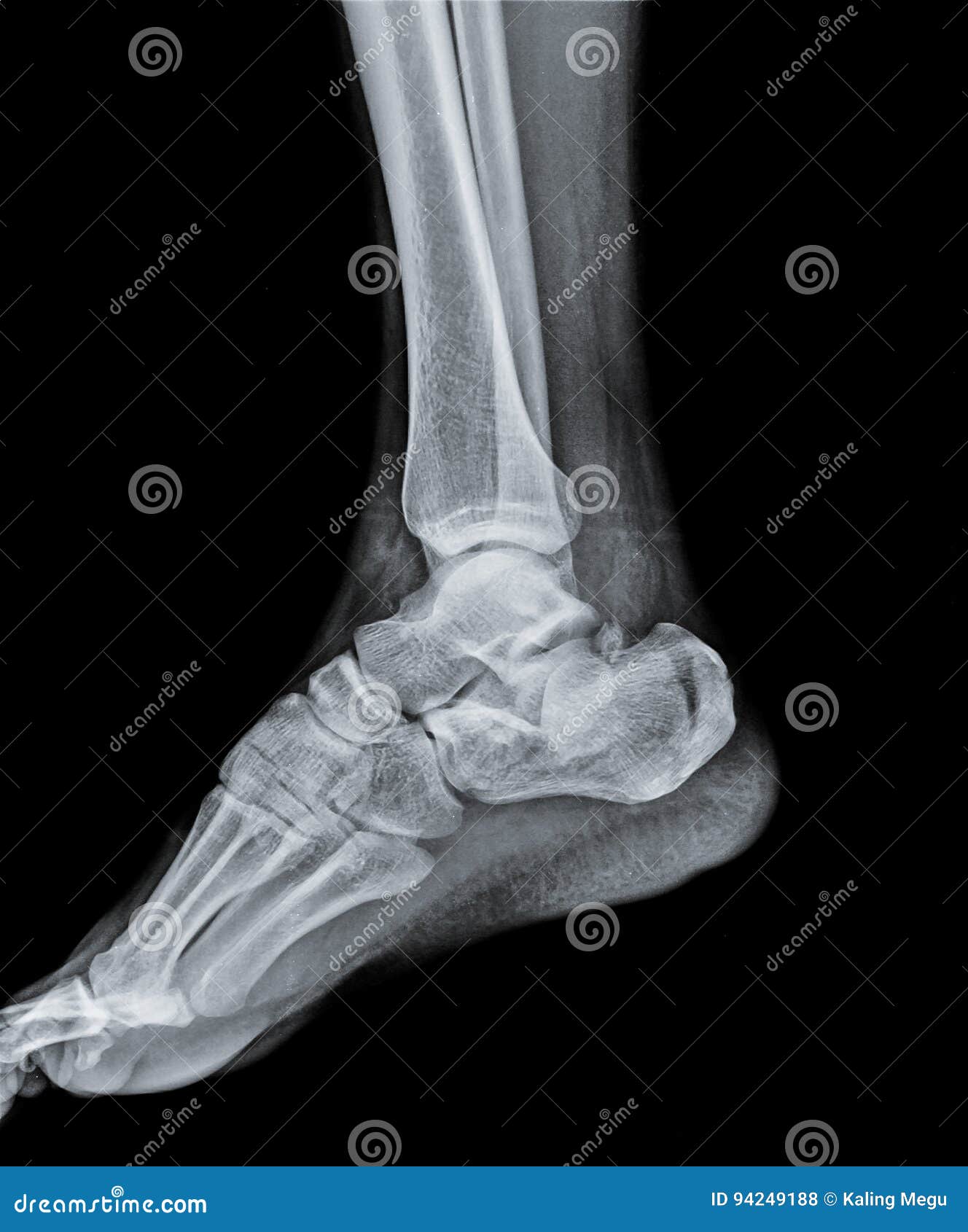 Ankle Joint with Foot and Tibia Stock Photo - Image of health, care ...
