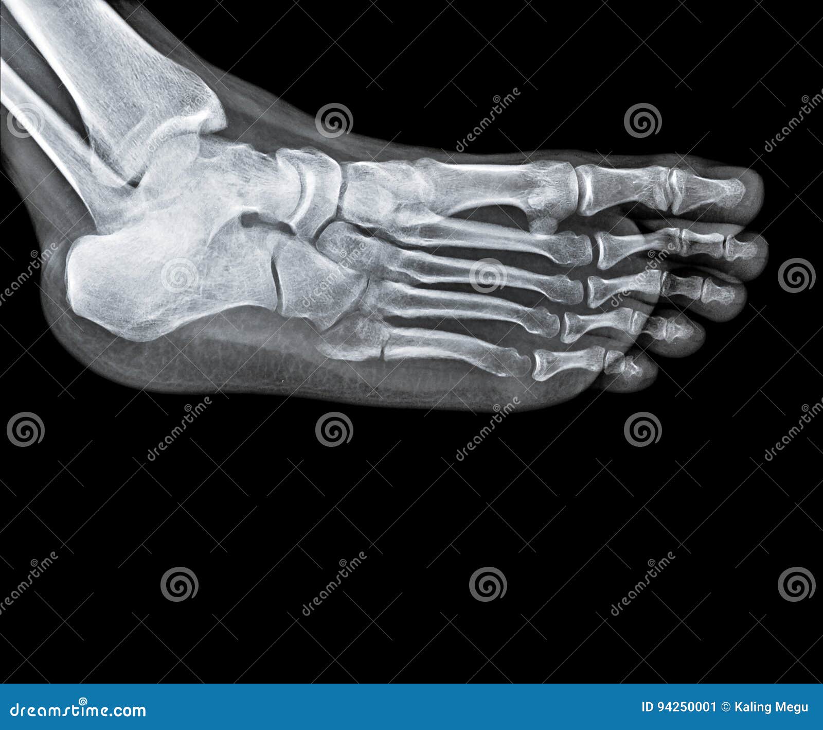 Ankle Joint with Foot and Tibia Stock Image - Image of patella, foot ...