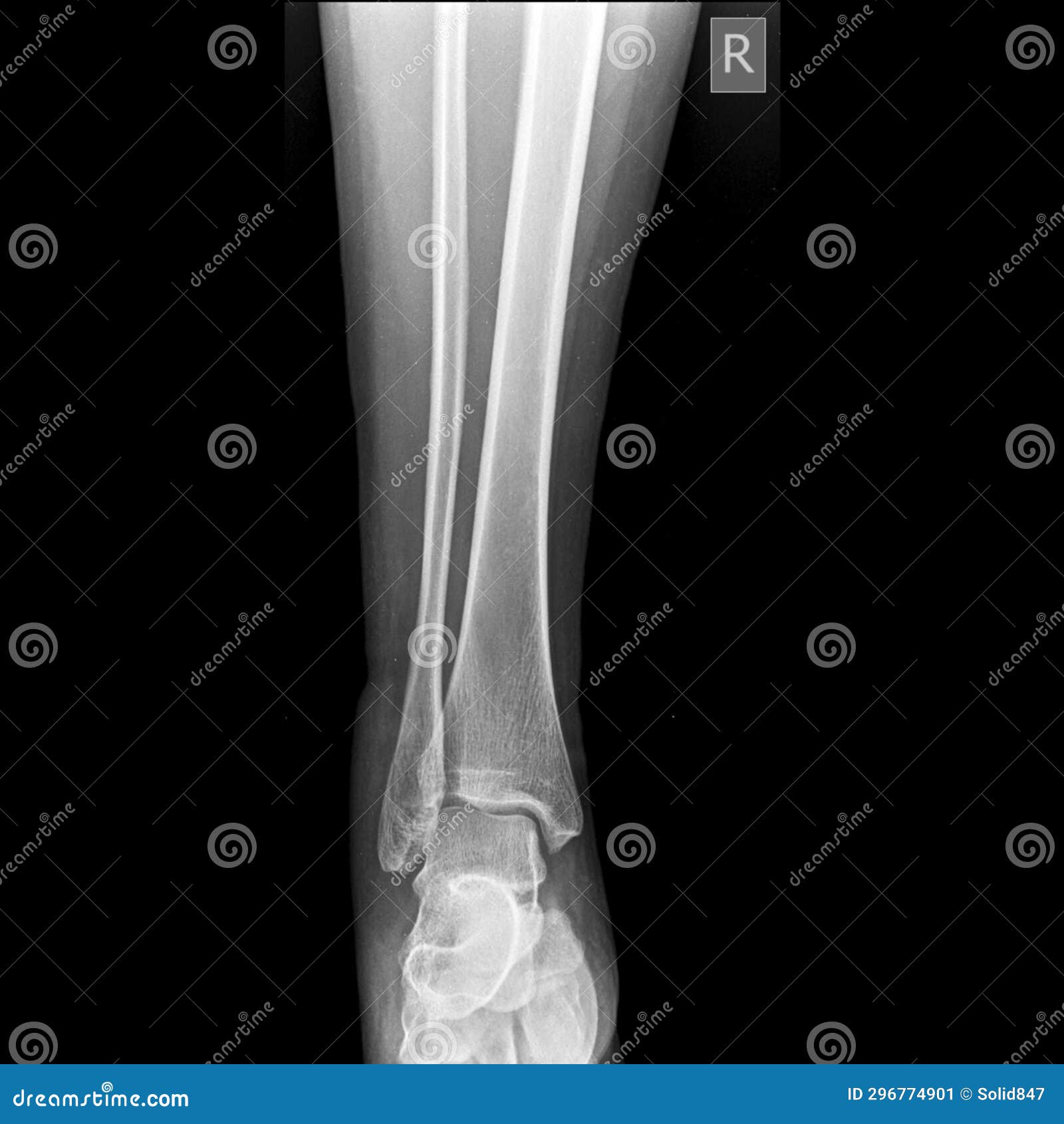 Ankle Joint and Lower Leg X-ray Image AP View Stock Image - Image of ...