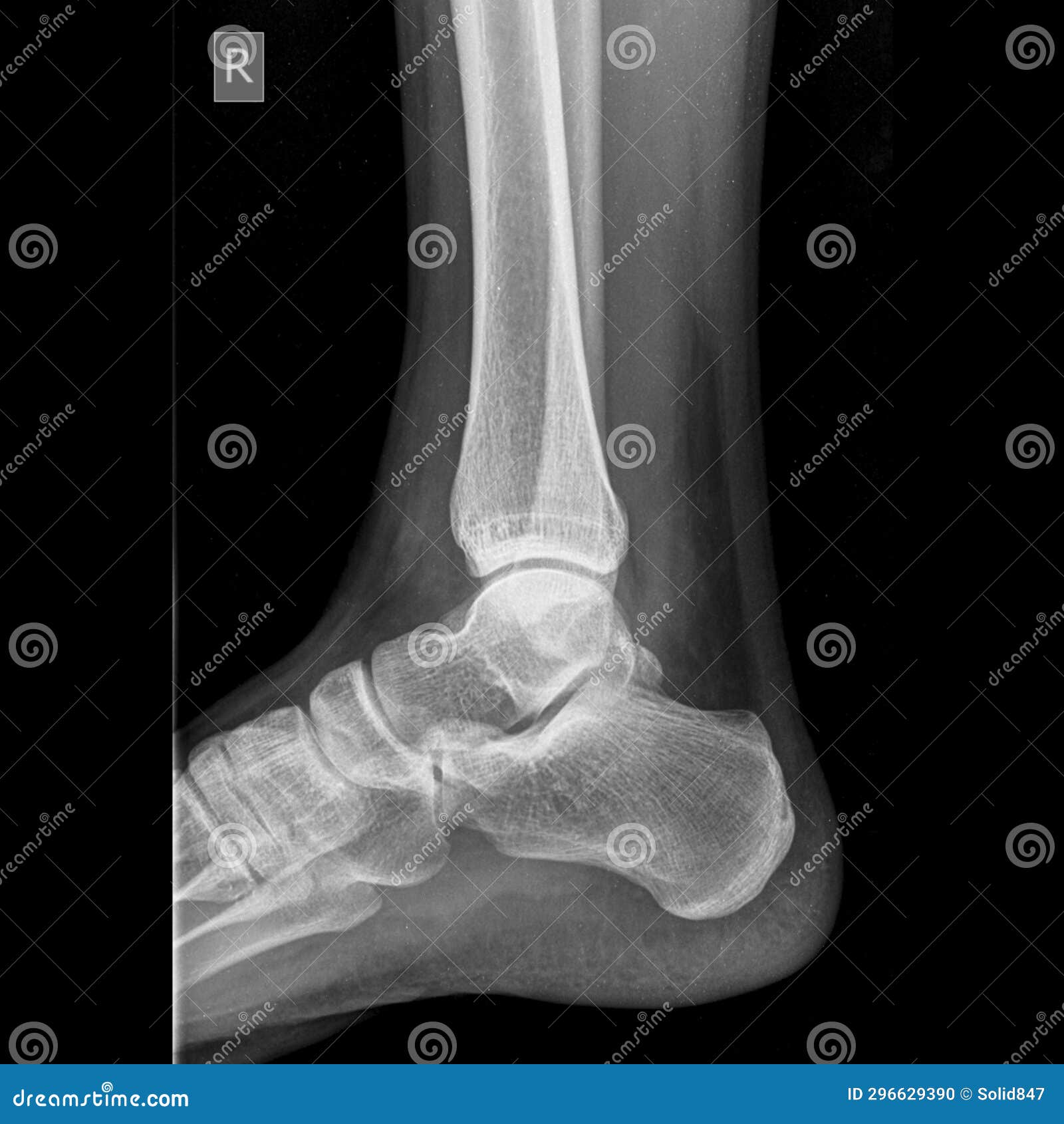 Ankle Joint X-ray Image Lateral View Stock Photo - Image of radiography ...