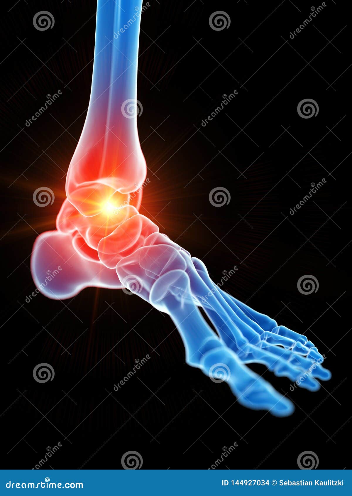 The Ankle Joint Showing Pain Stock Illustration - Illustration of gout ...