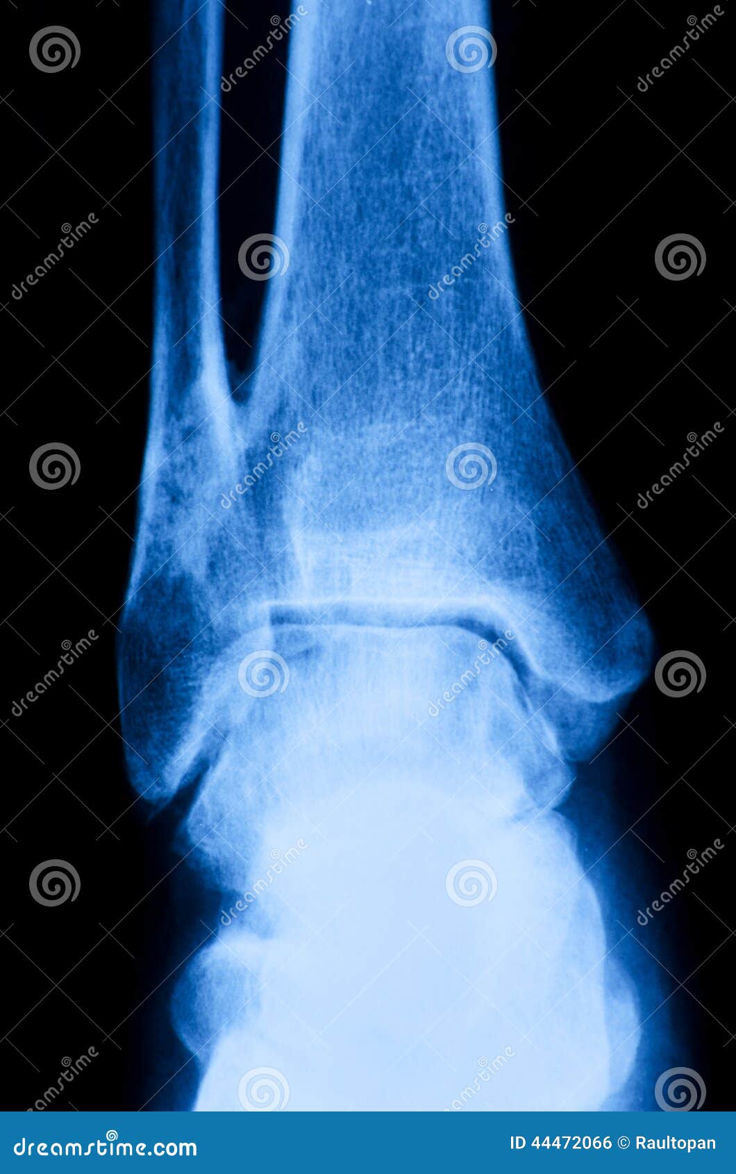 Ankle x-ray stock photo. Image of radiology, health, trauma - 44472066