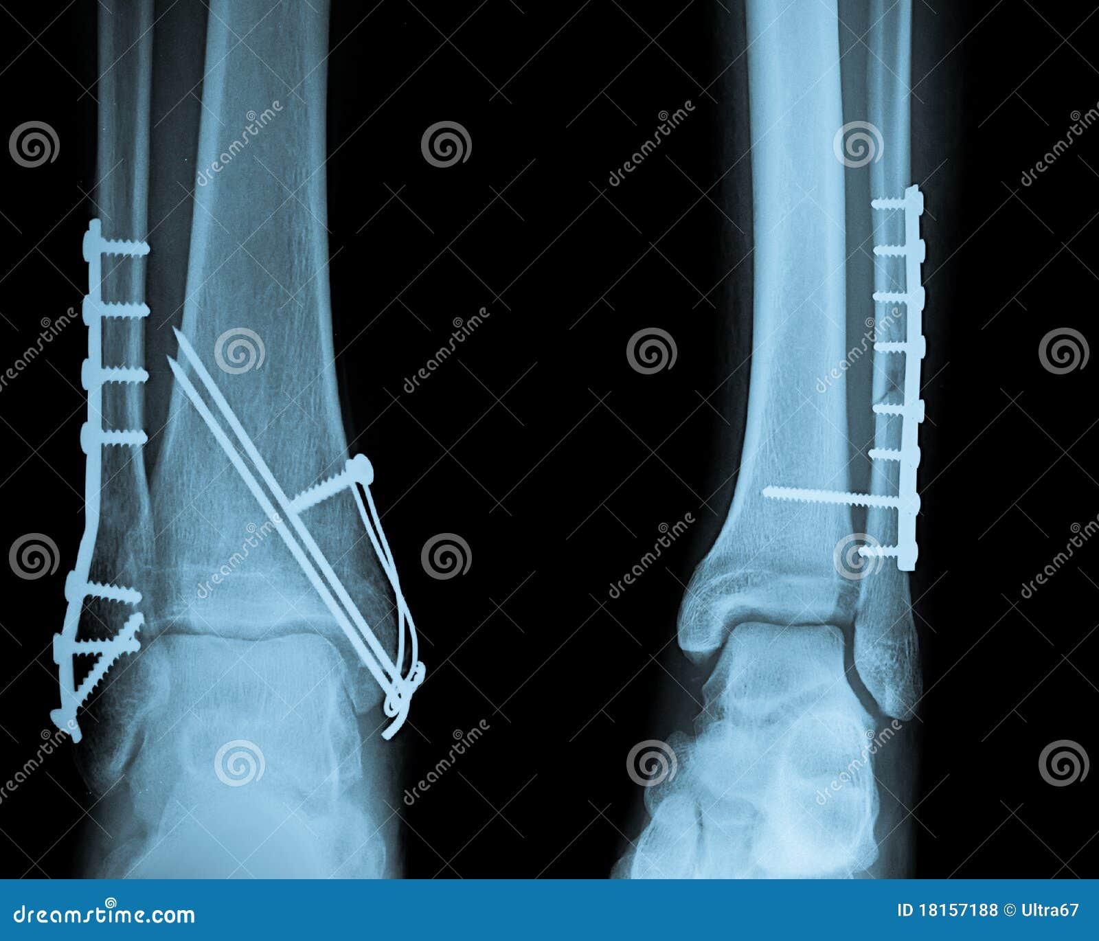 Ankle X Ray with Osteosynthesis Stock Photo - Image of cosmetic ...
