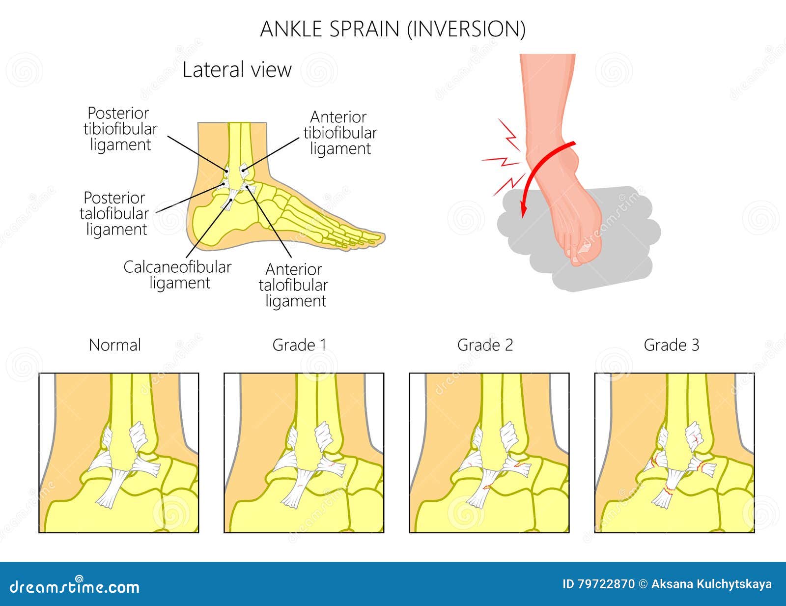 Ankle sprain.Inversion stock vector. Illustration of articulation ...