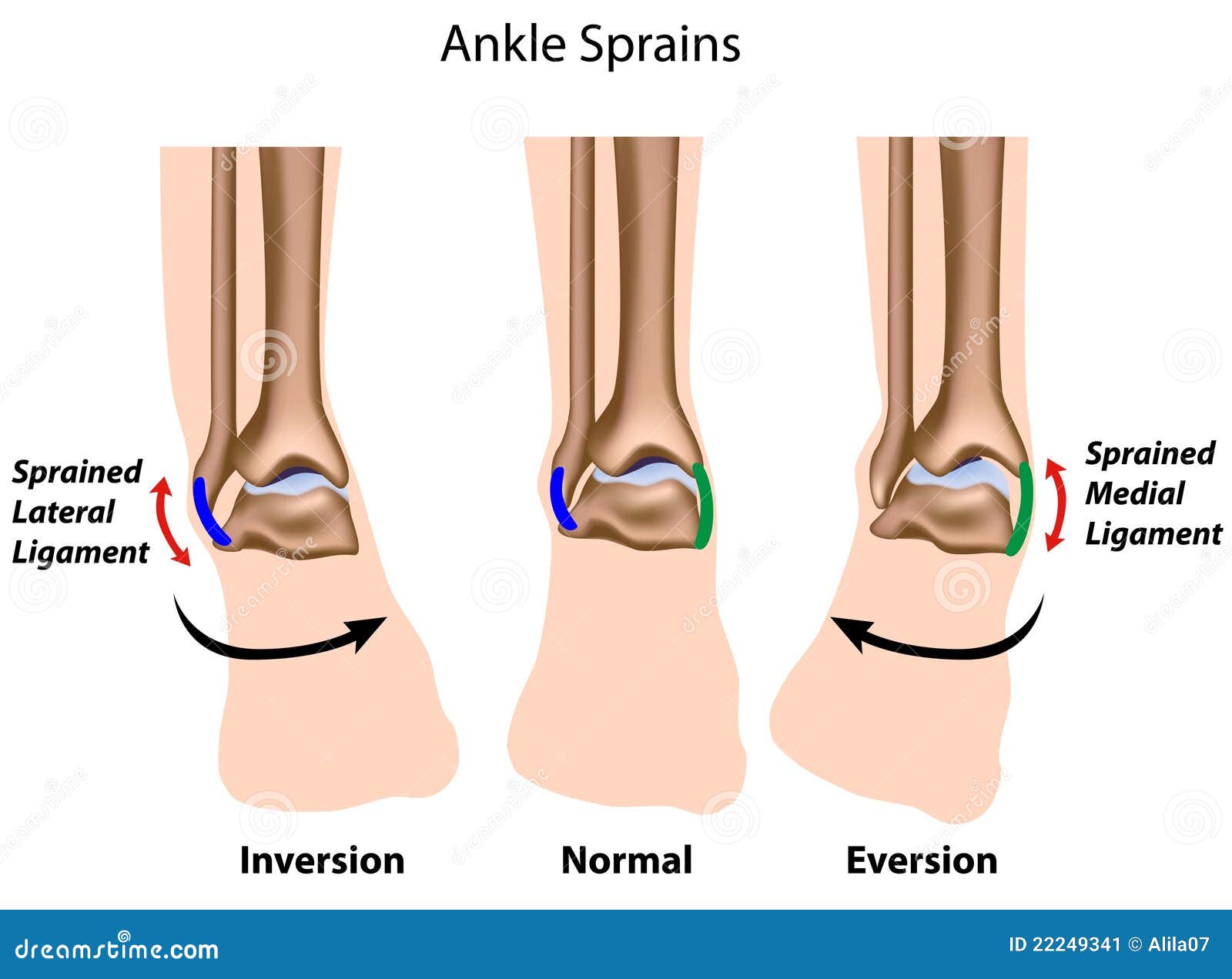 Ankle sprains stock illustration. Illustration of articular - 22249341