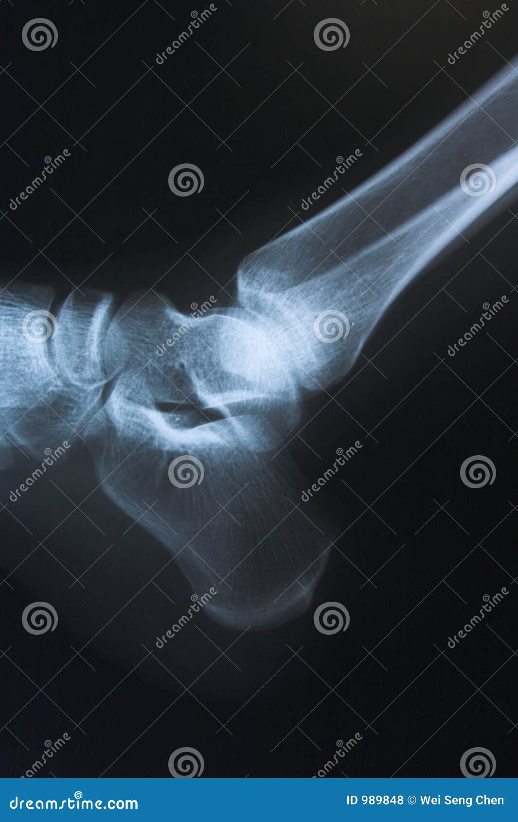 X-ray Ankle Or Radiographic Image Or X-ray Image Of Right Ankle Joint ...