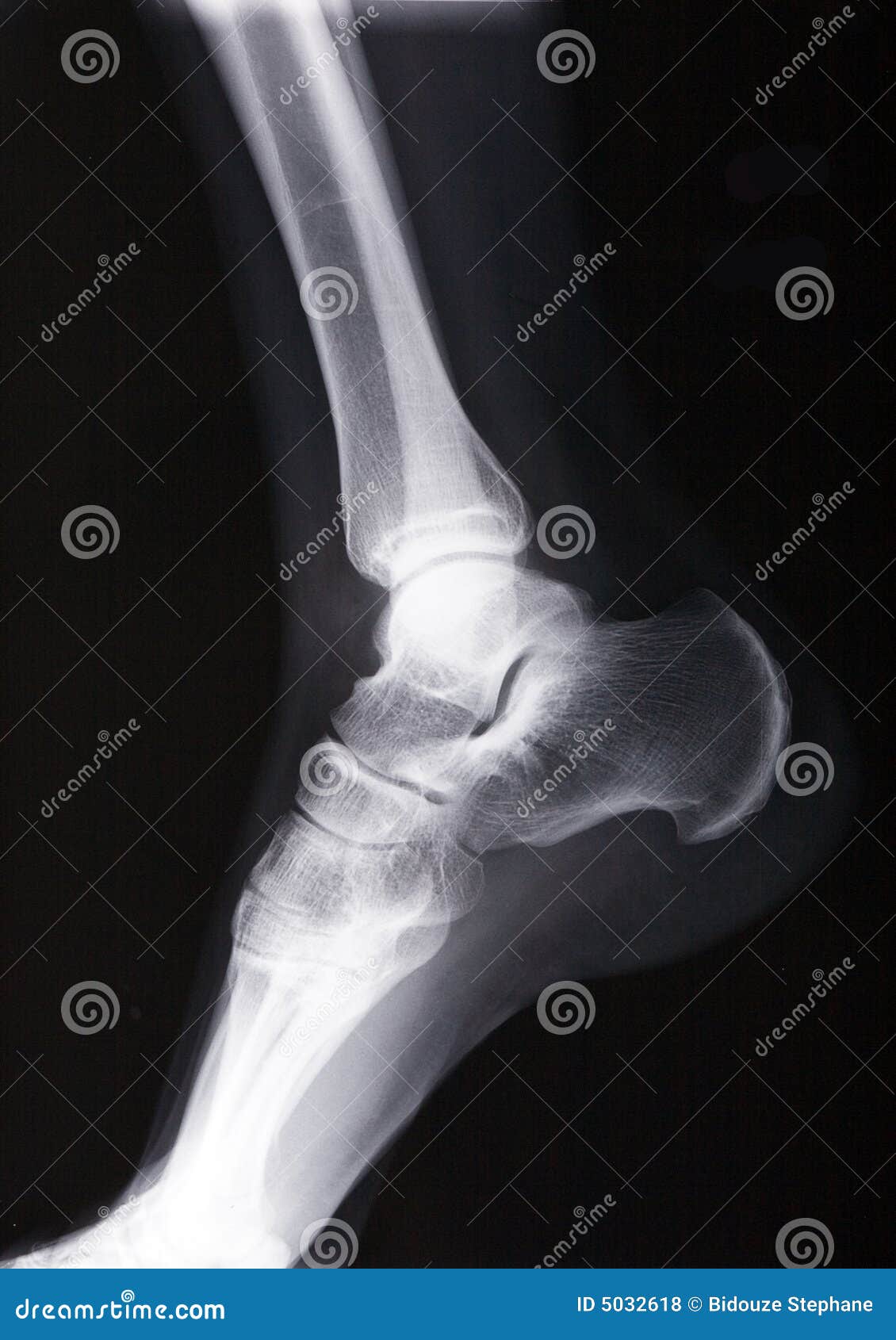 Ankle xray stock photo. Image of diagnosis, medicine, scan - 5032618