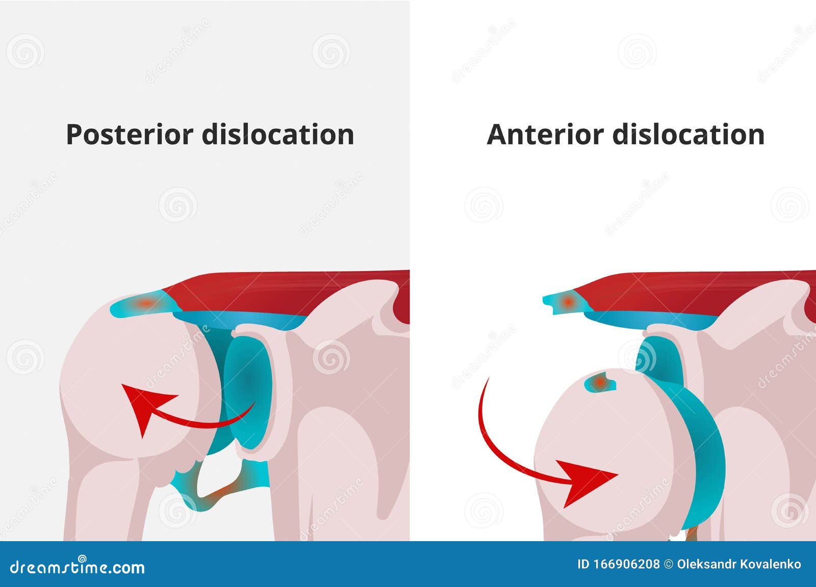 Anterior and Posterior Shoulder Dislocation Vector Illustration Stock ...