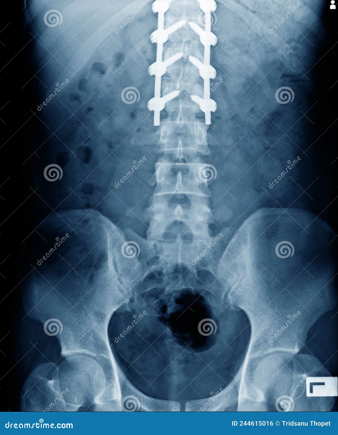 Anterior View of Structure Bone with Internal Fixation Stock Photo ...