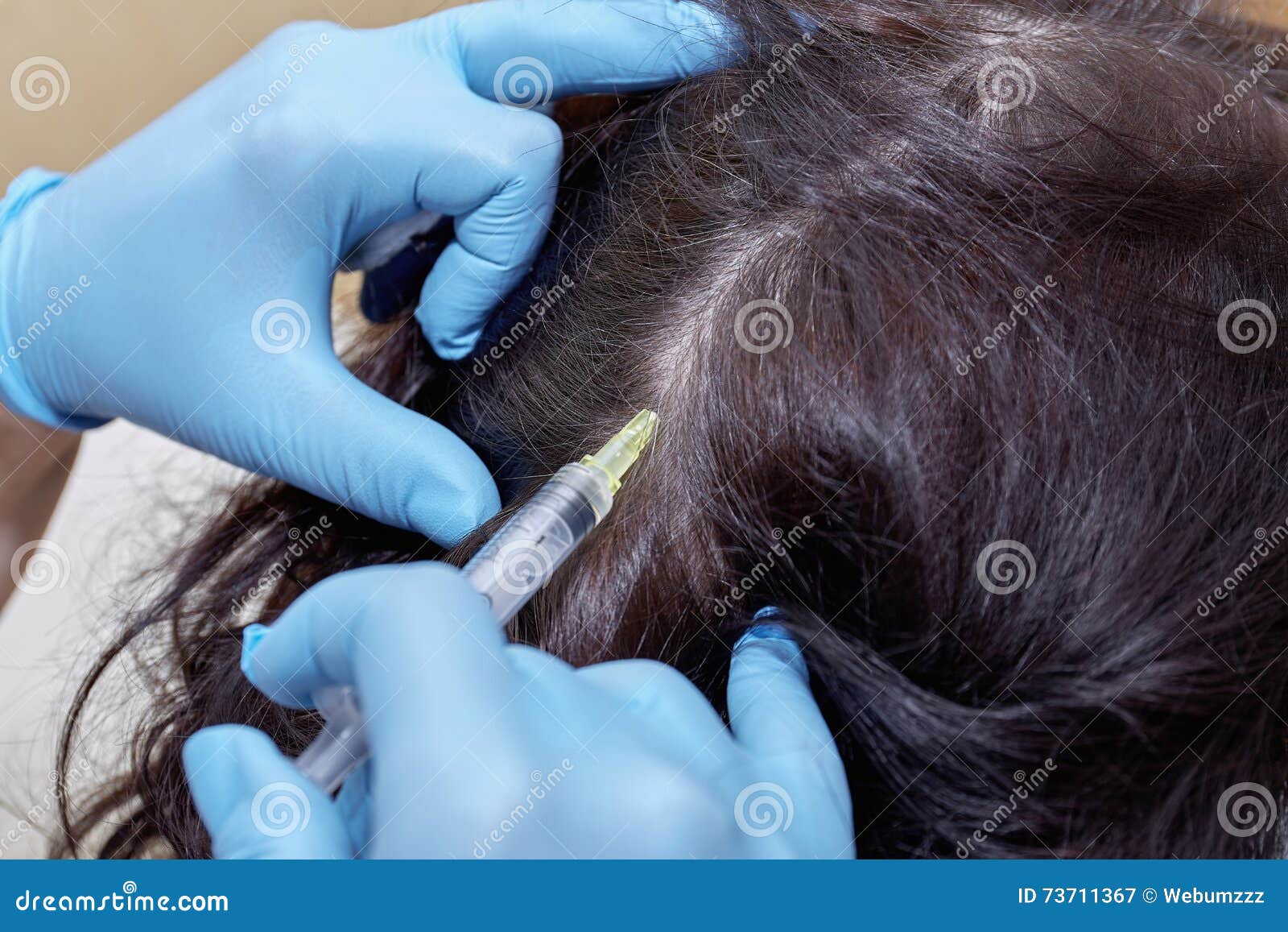 Anti Hair Loss Injection in Clinic. Stock Image - Image of clinic ...