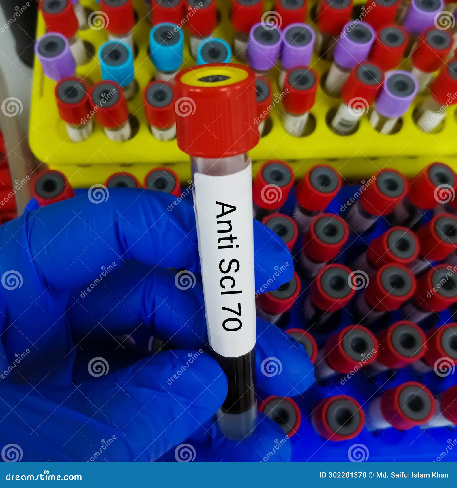 Anti–Scl-70 Antibody, Diagnosis of Scleroderma Stock Photo - Image of ...