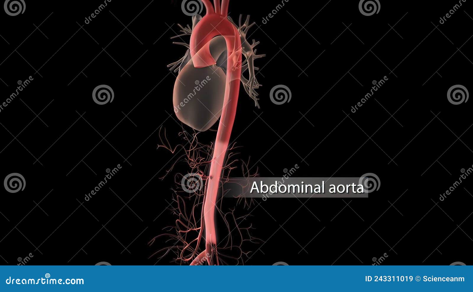 Aortic Aneurysm and Aortic Dissection Stock Illustration - Illustration ...