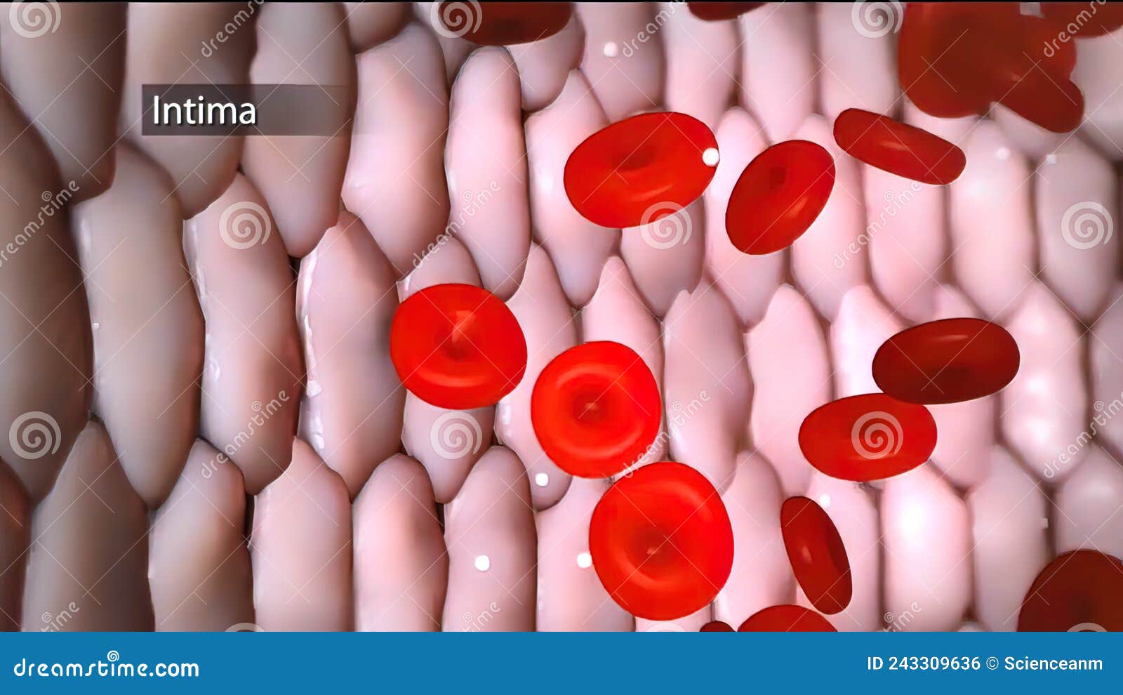 Aortic Dissection. Longitudinal And Cross-section Of Blood Vessel ...