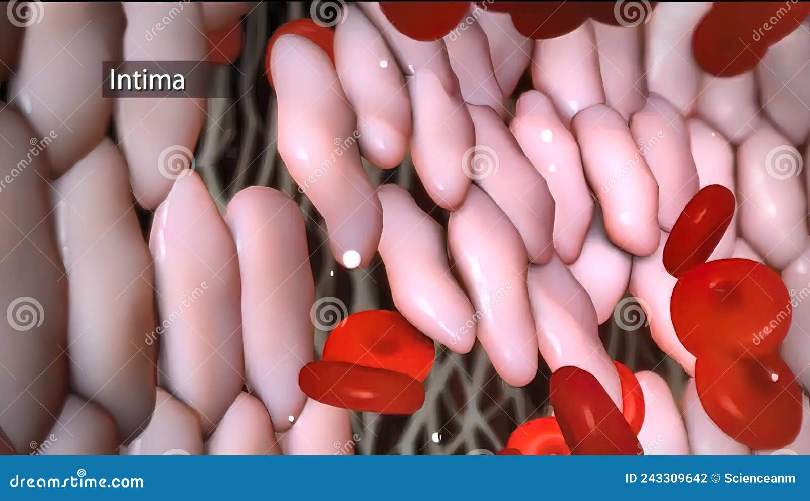 Aortic Dissection. Longitudinal And Cross-section Of Blood Vessel ...