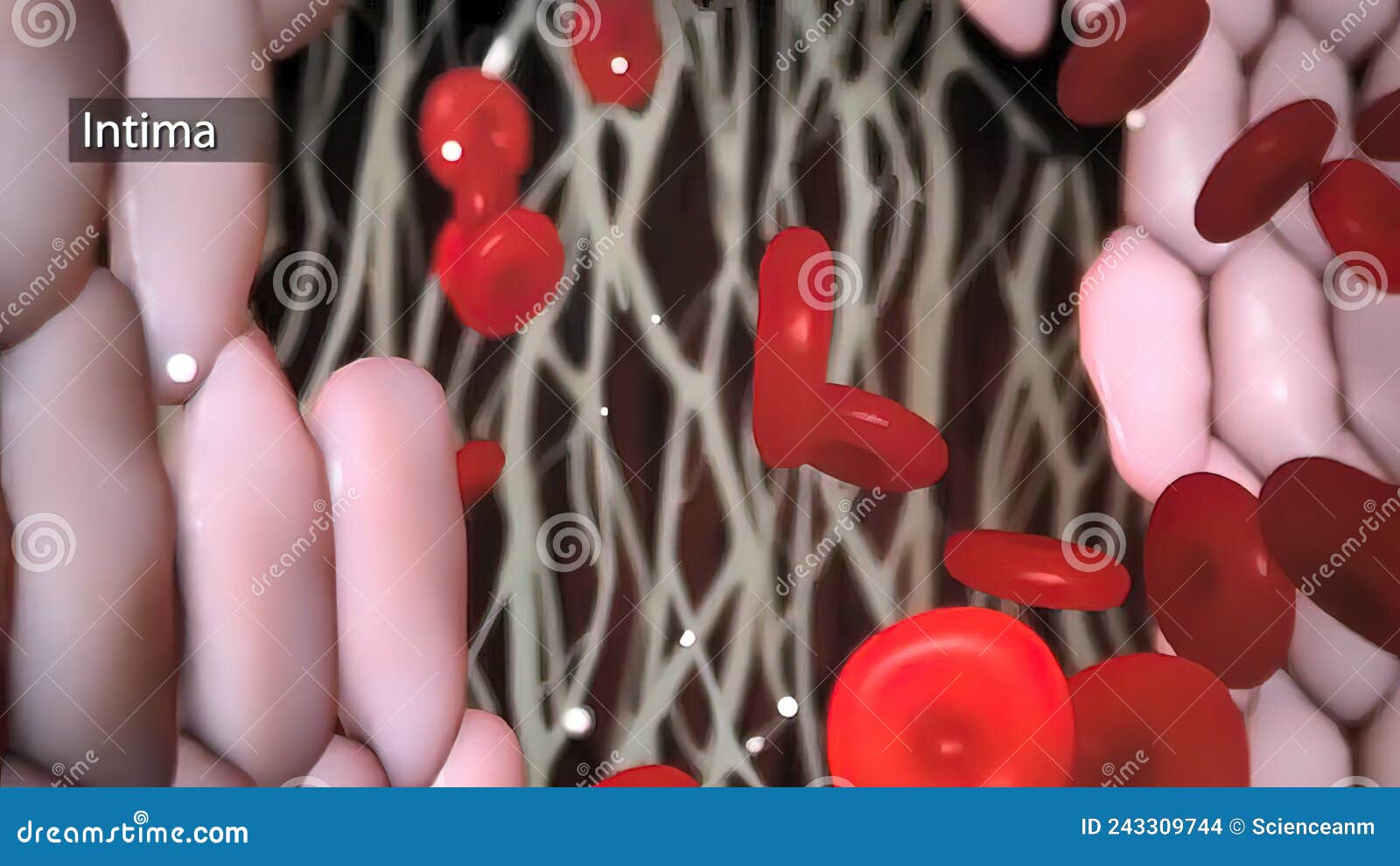 Aortic Dissection. Longitudinal And Cross-section Of Blood Vessel ...