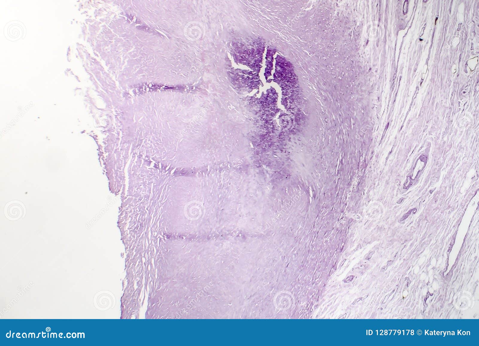 Aortic Atherosclerosis, Light Micrograph Stock Photo - Image of ...