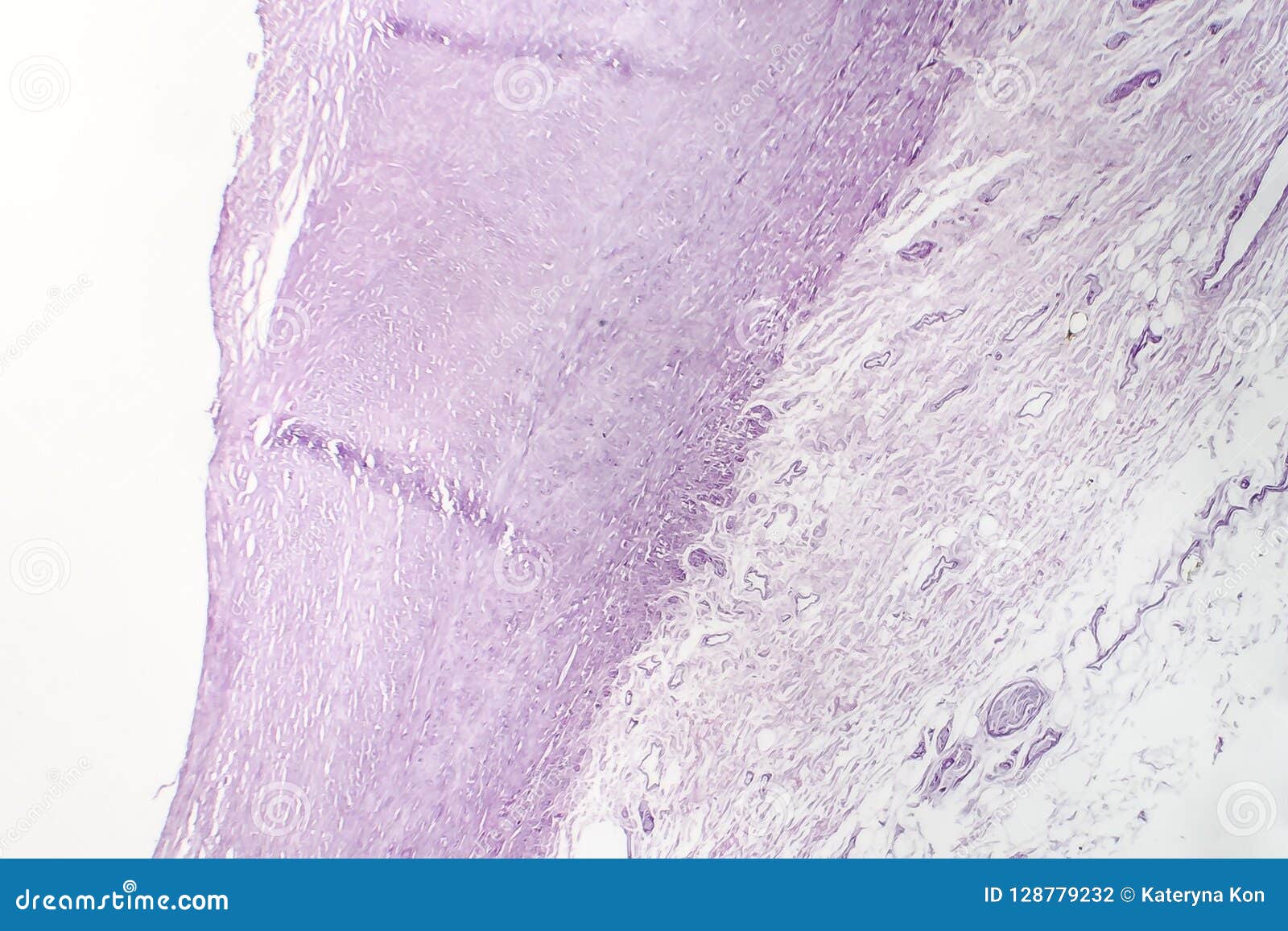 Aortic Atherosclerosis, Light Micrograph Stock Photo - Image of ...