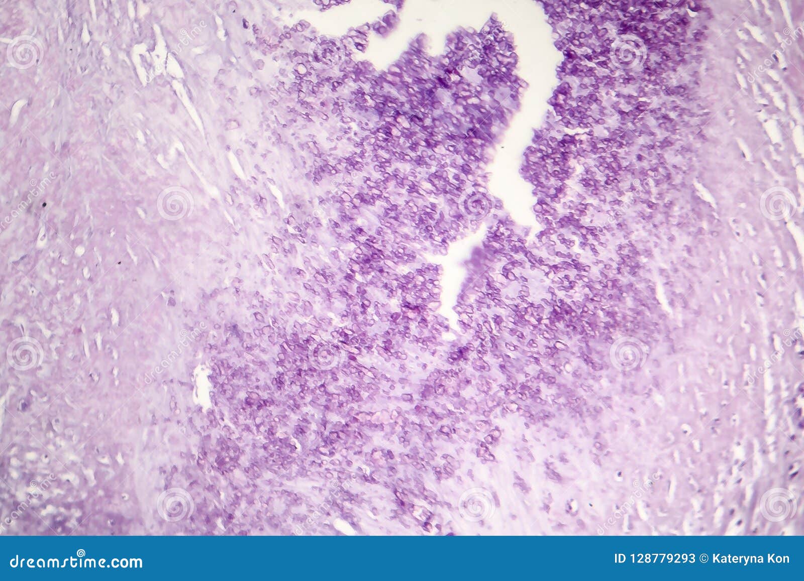 Aortic Atherosclerosis, Light Micrograph Stock Image - Image of ...