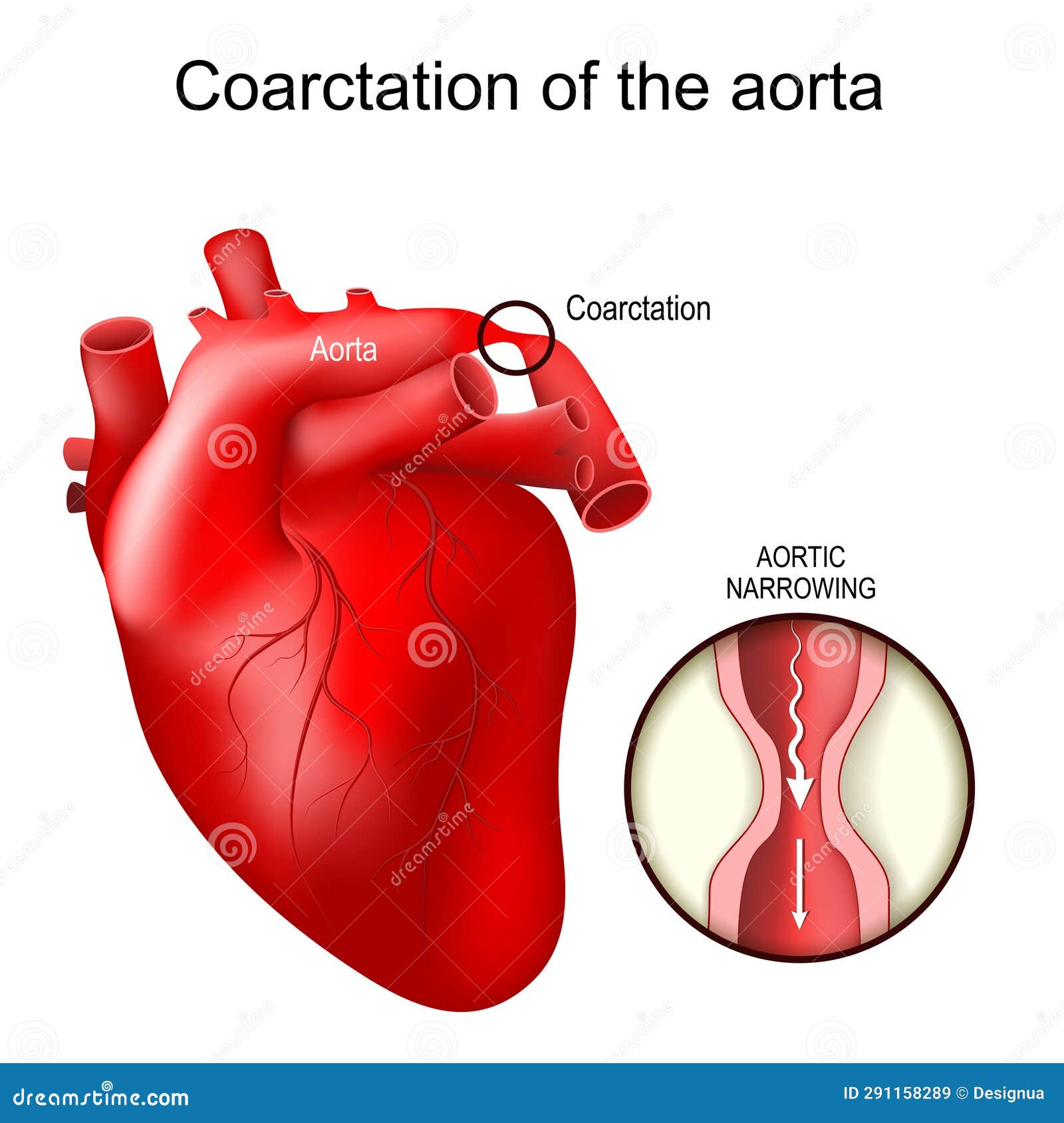 Aortic Coarctations Congenital Heart Defect Stock Illustration