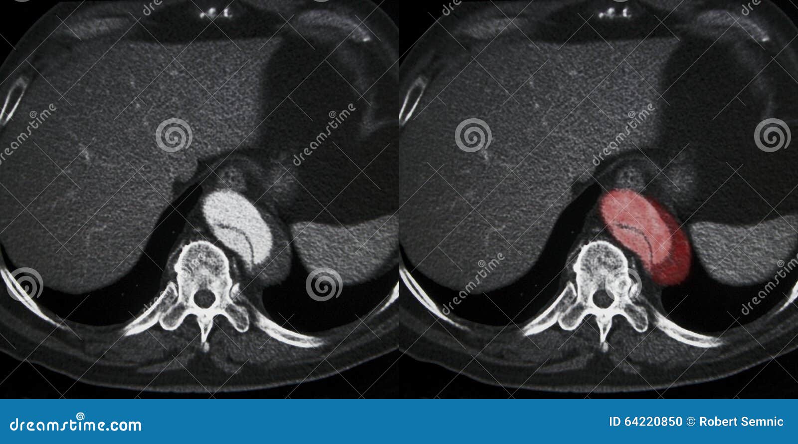 Aortic dissection, CT stock photo. Image of symbol, colored - 64220850