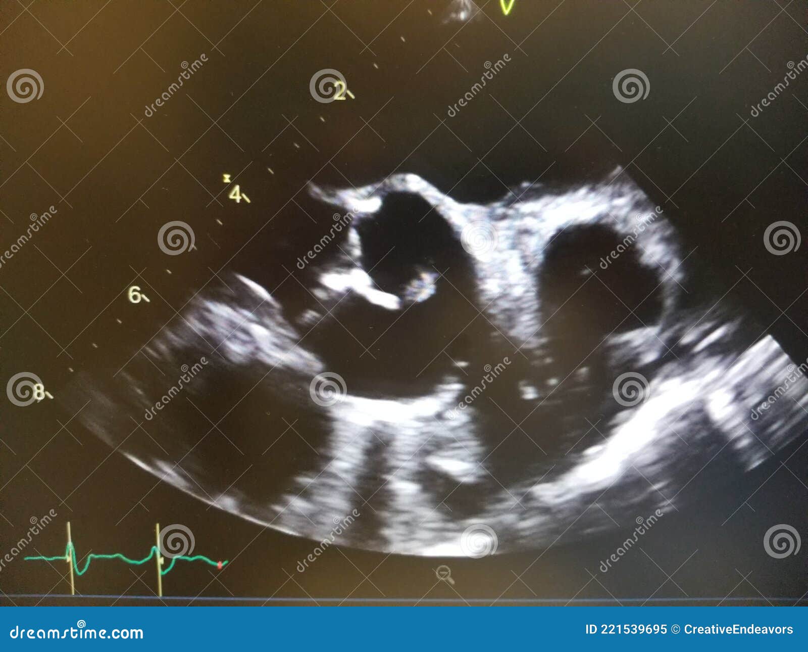 Aortic Valve Vegetation Shown on Live Echocardiogram Stock Image ...