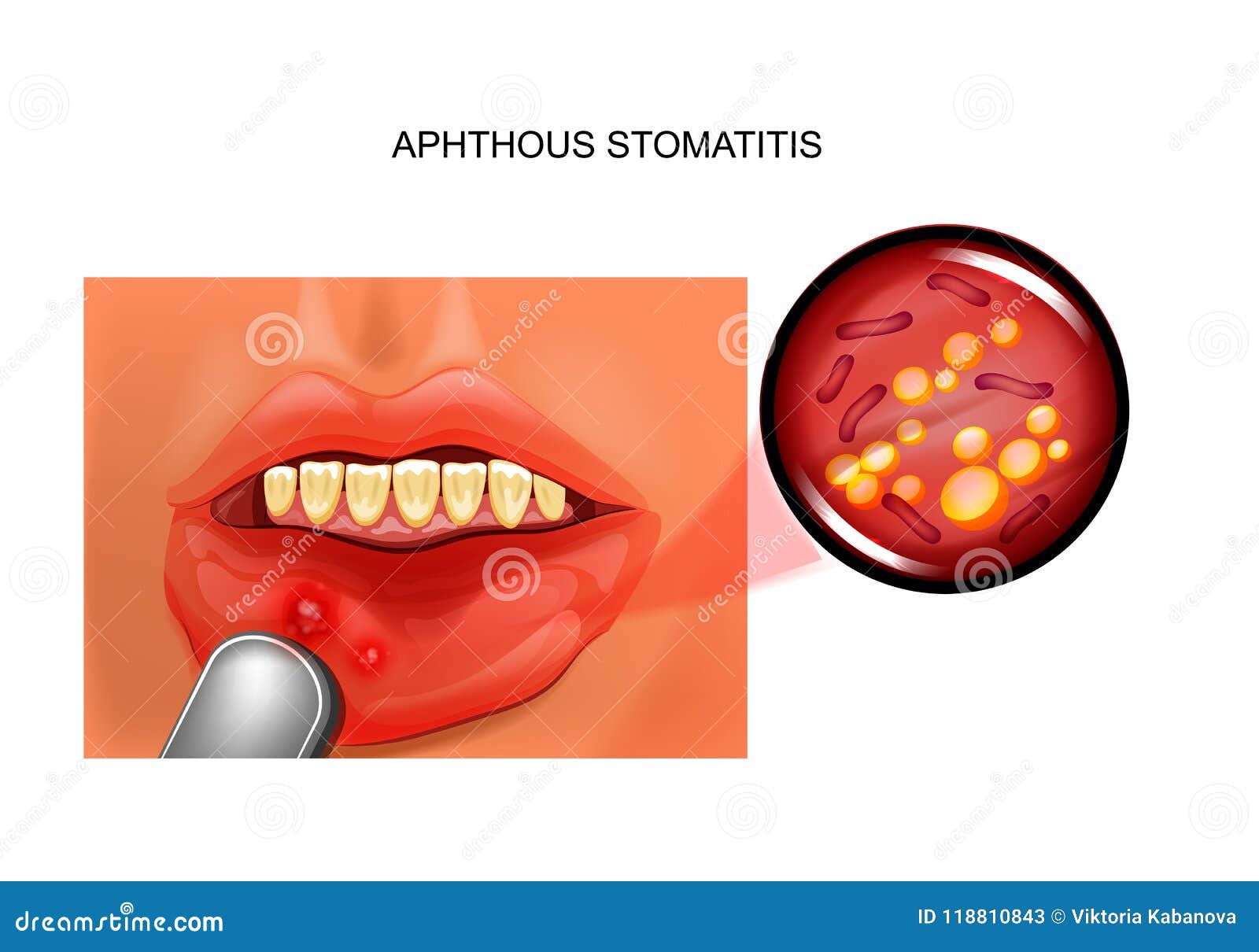 Aphthous Stomatitis. Aphthae Stock Vector - Illustration of mushroom ...
