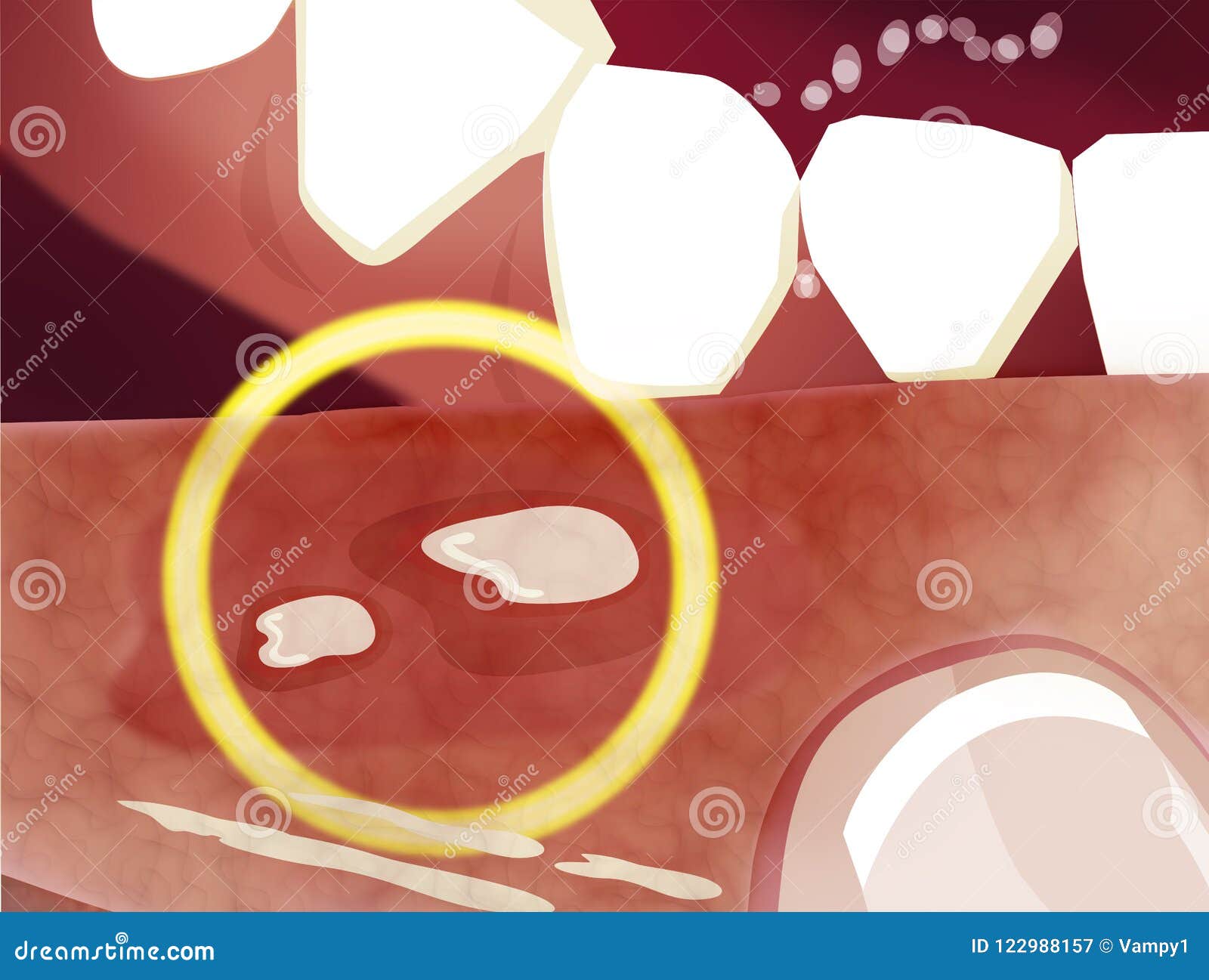 Aphthous Stomatitis is a Common Condition Characterized by the Repeated ...
