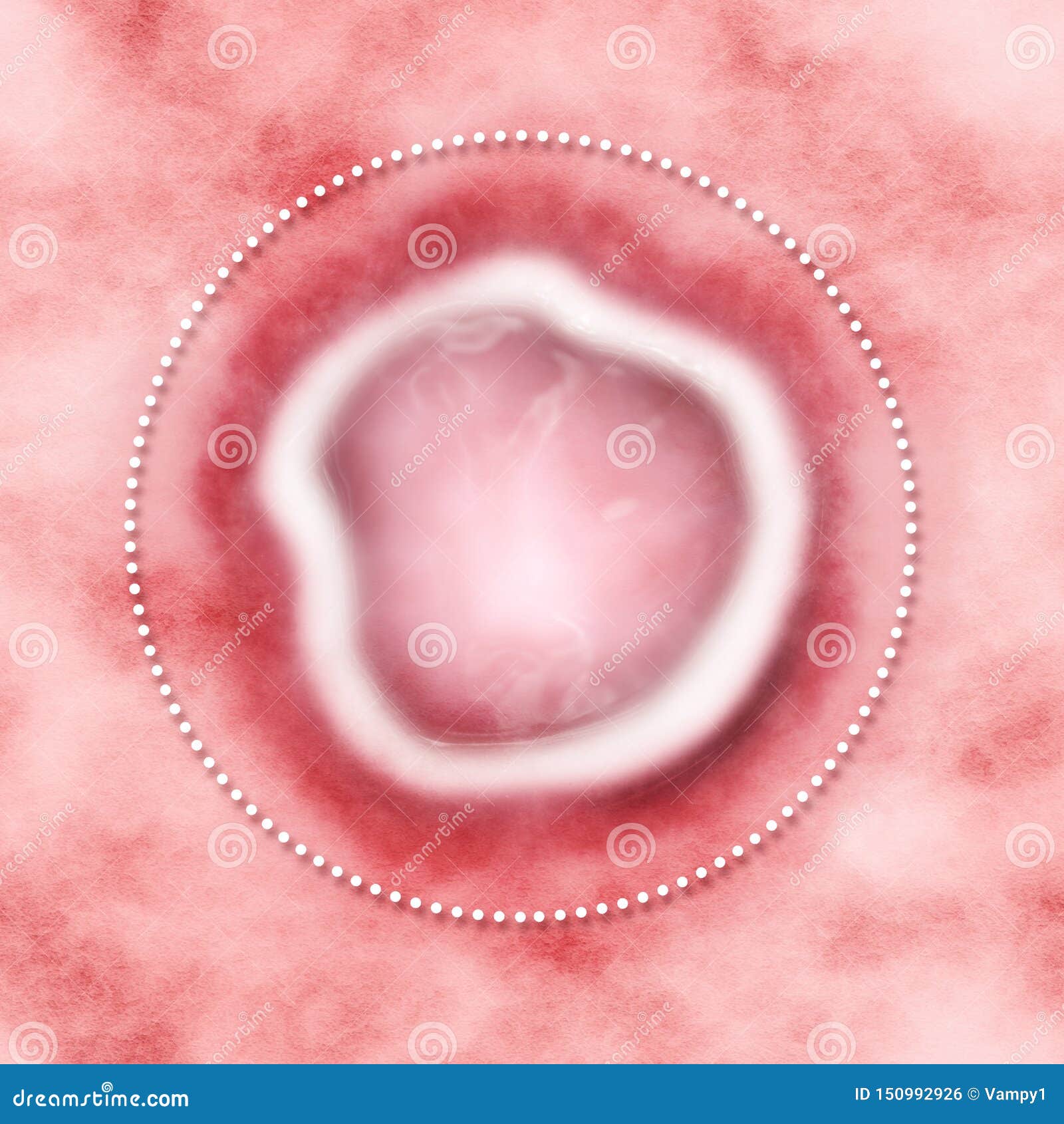 Aphthous Stomatitis Is A Common Condition Characterized By The Repeated Formation Of Benign And